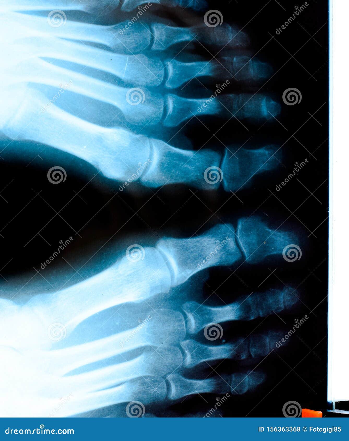 X-ray of Toes. Foot on Xray. Bone Stock Photo - Image of orthopedic ...