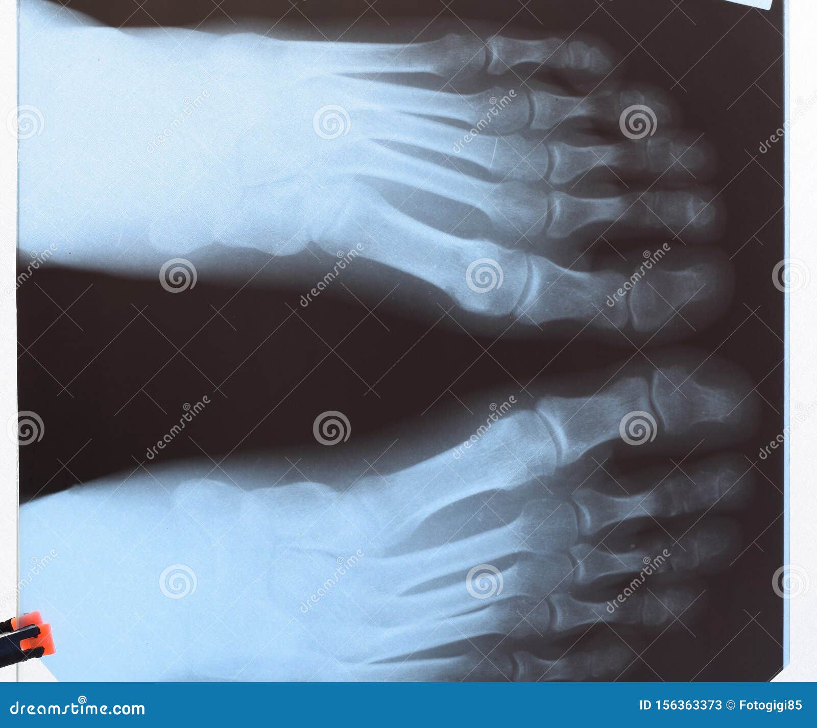 X-ray of Toes. Foot on Xray. Bone Stock Image - Image of care, bone ...