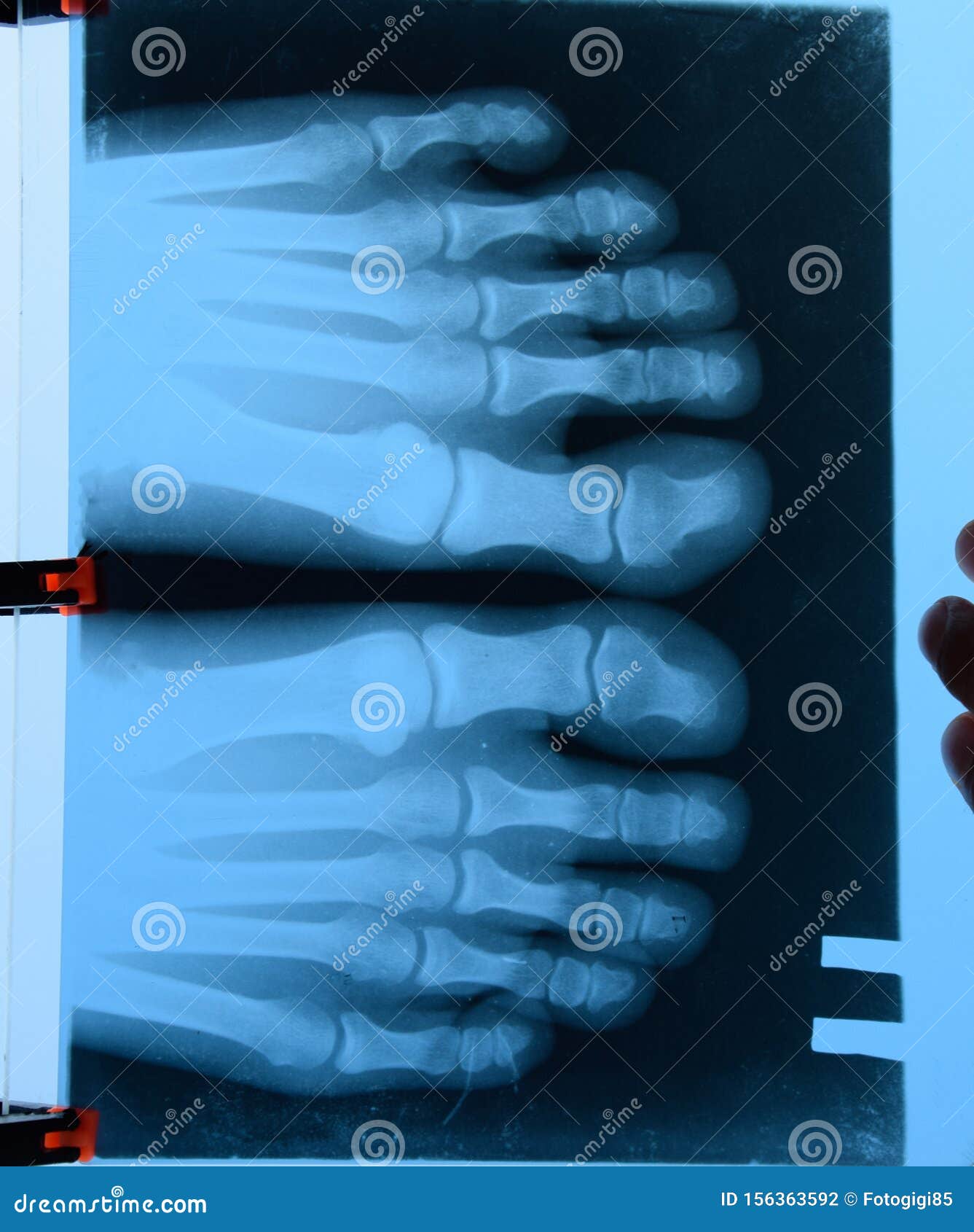 X-ray of Toes. Foot on Xray. Bone Stock Photo - Image of biology ...