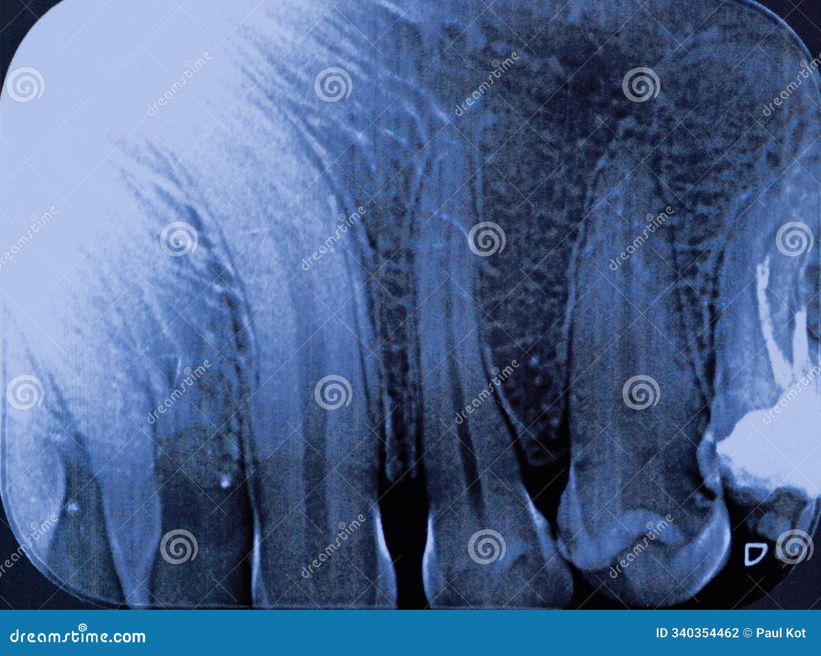X-ray of the Tooth, Close-up Stock Illustration - Illustration of ...