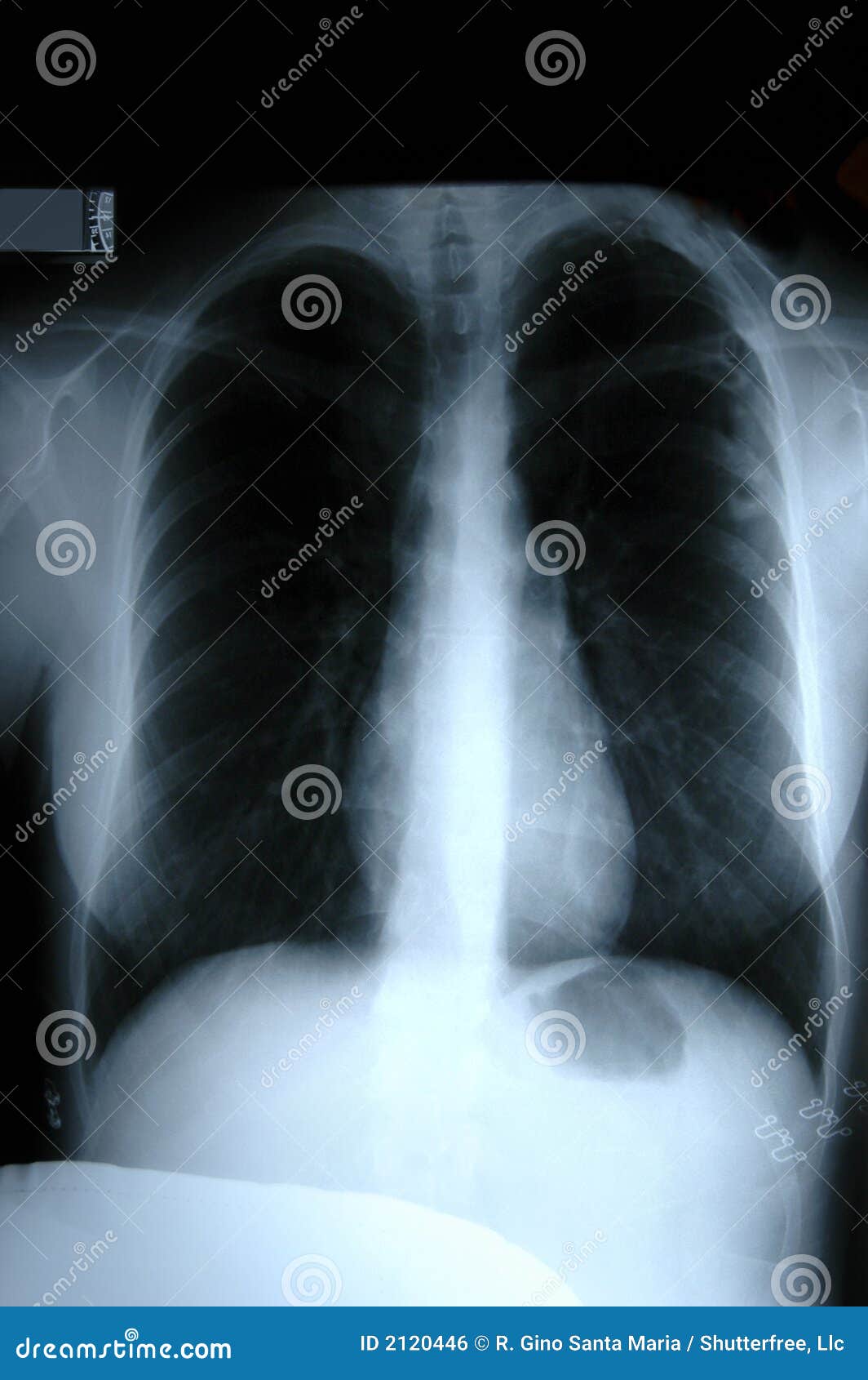 X-ray of Torso stock photo. Image of inside, check, medical - 2120446