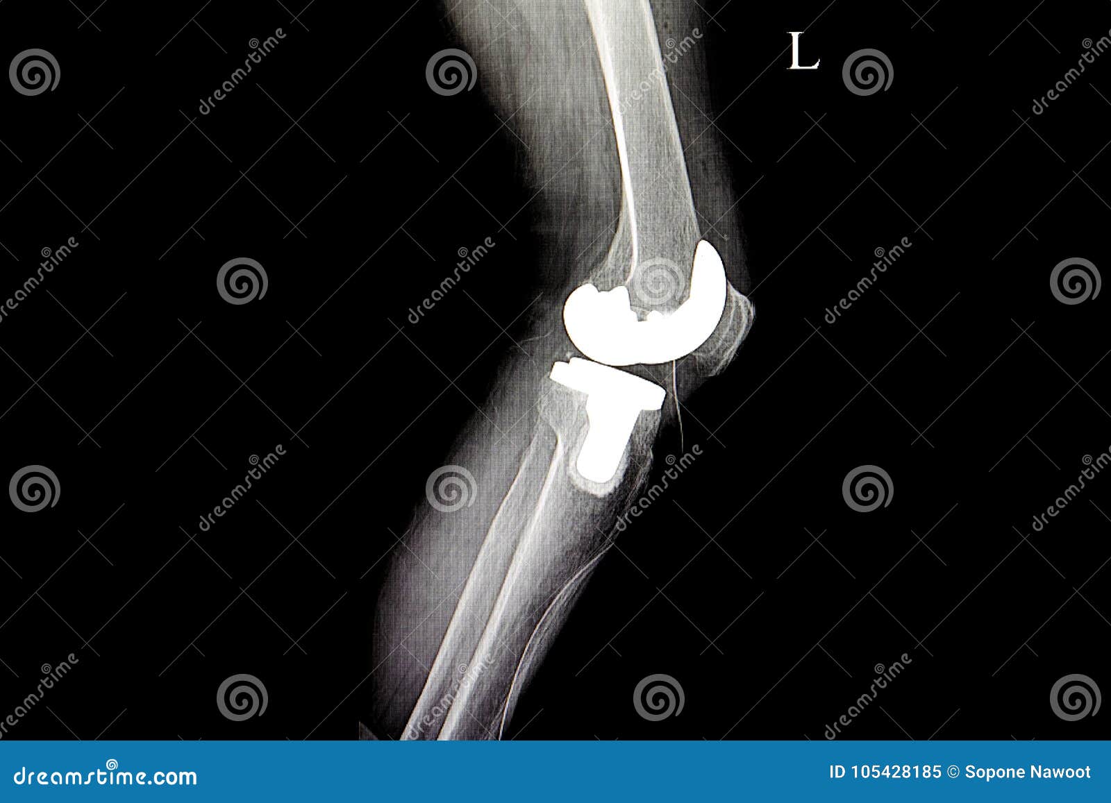 X-ray Total Knee Replacement Stock Image - Image of osteoarthritis ...