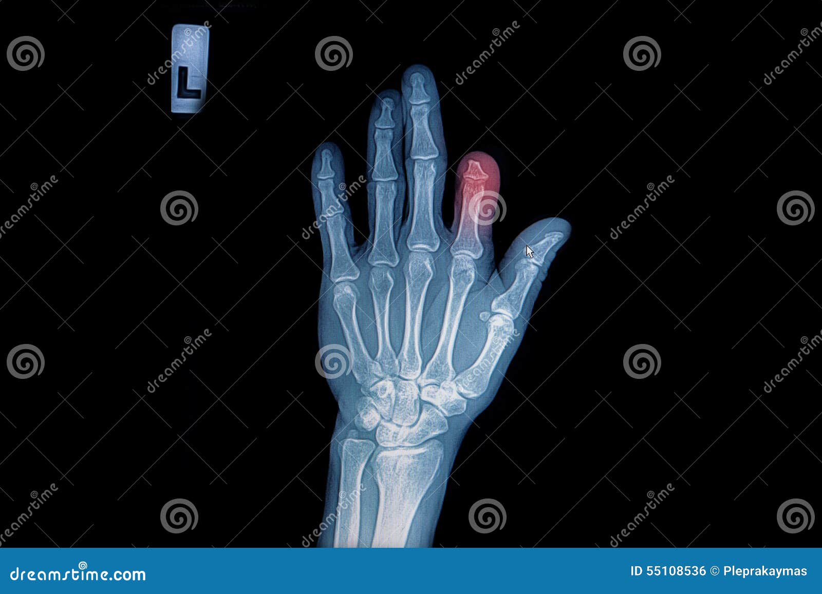 X-ray of trauma hand stock photo. Image of xray, human - 55108536
