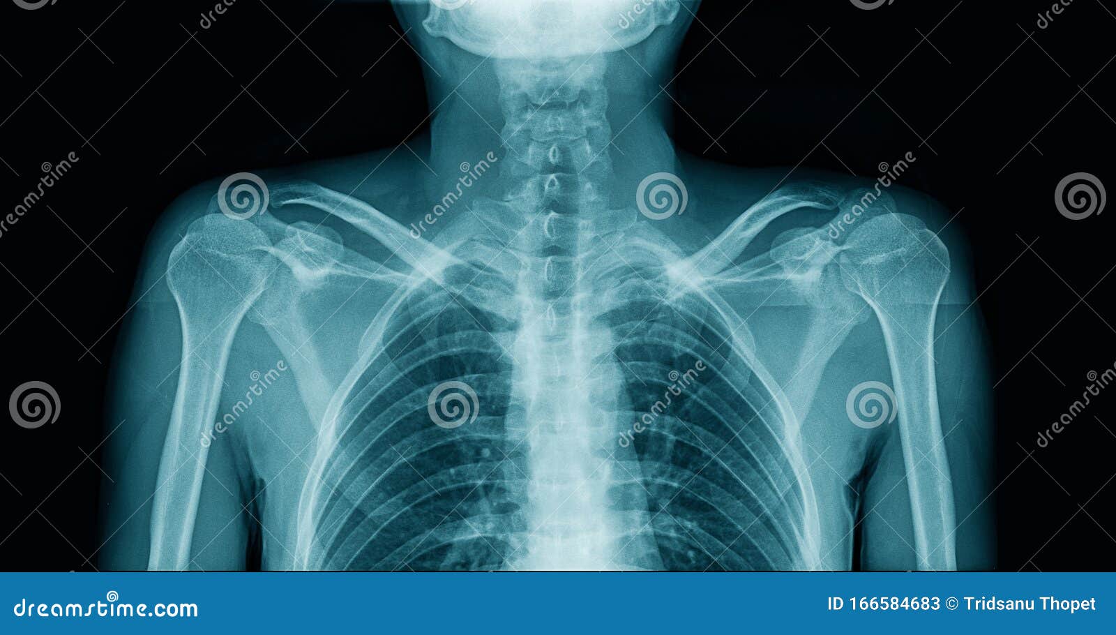 X-ray upper part of human stock image. Image of injury - 166584683