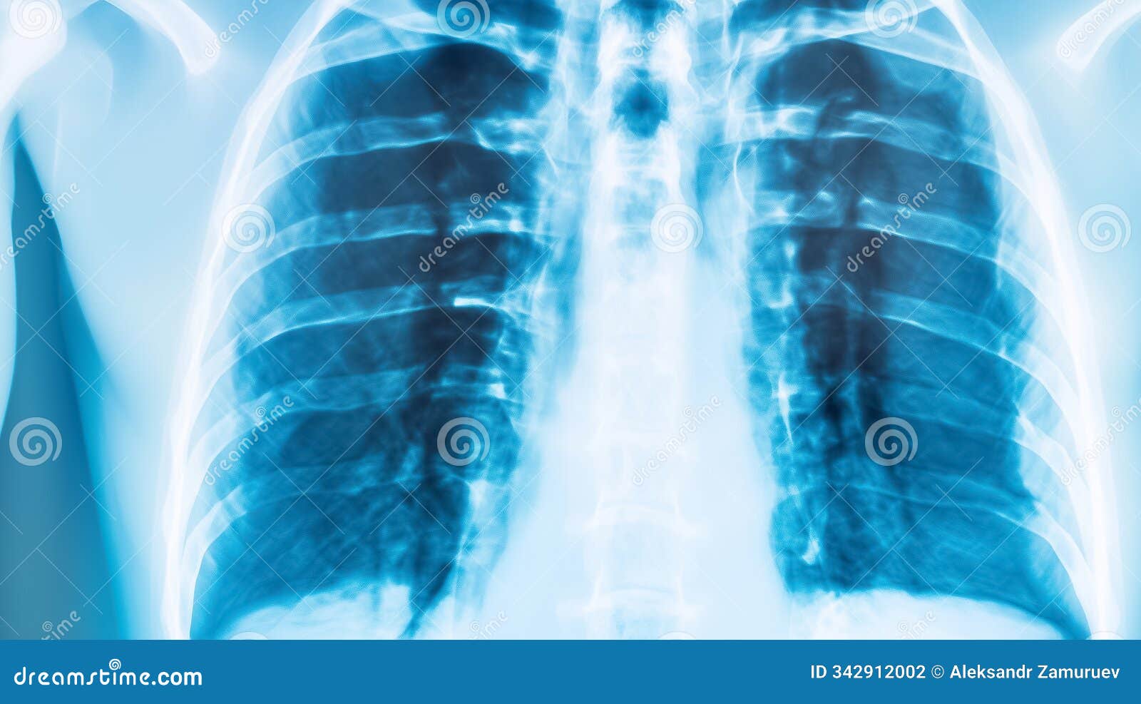 X-ray Views Reveal the Complex Anatomy of the Thorax, Highlighting Lung ...