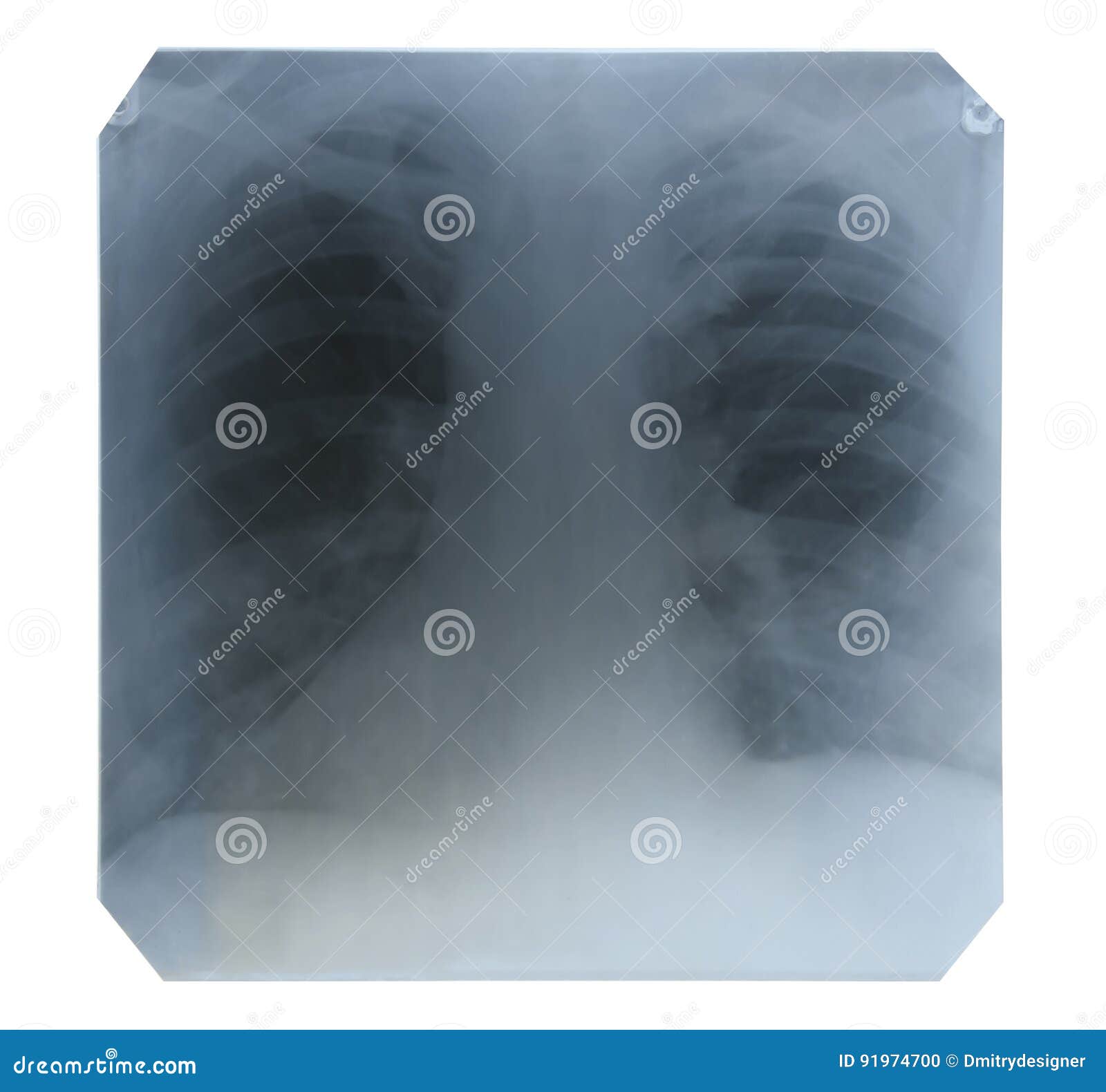 X-ray on white background stock photo. Image of radiation - 91974700