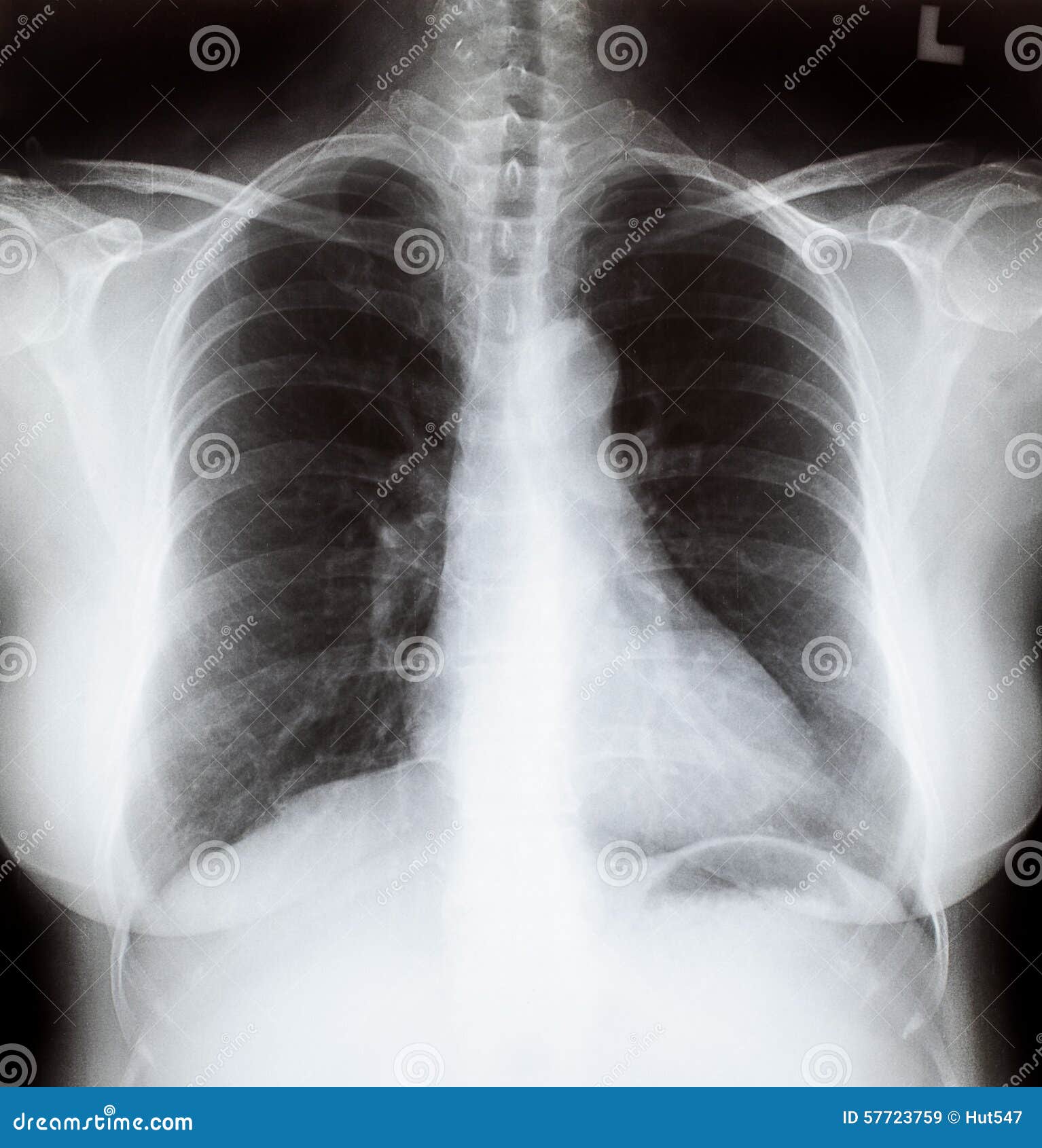 Normal Chest X Ray Female