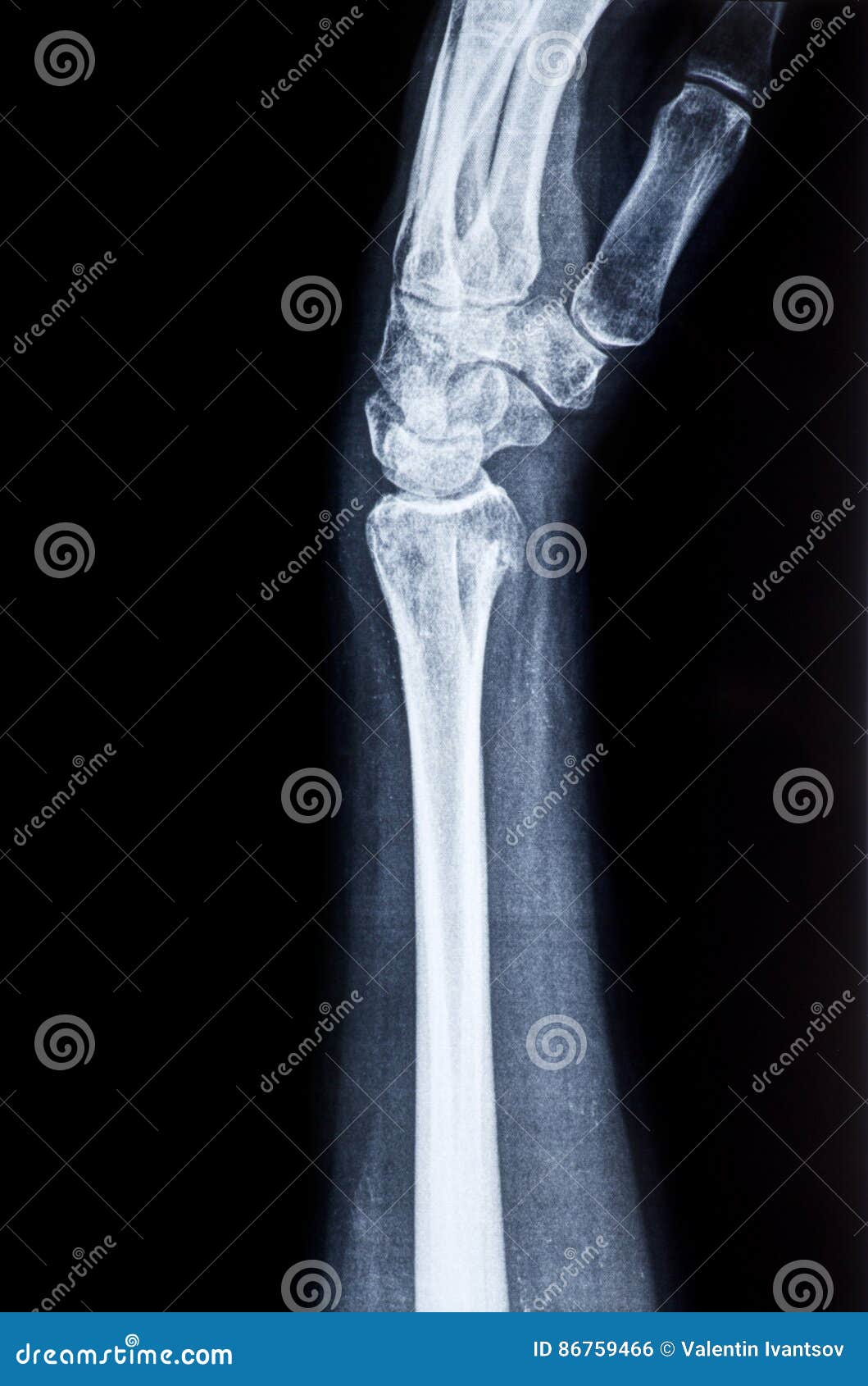 X Ray Of Human Hand With Broken Wrist Fracture Of Radius