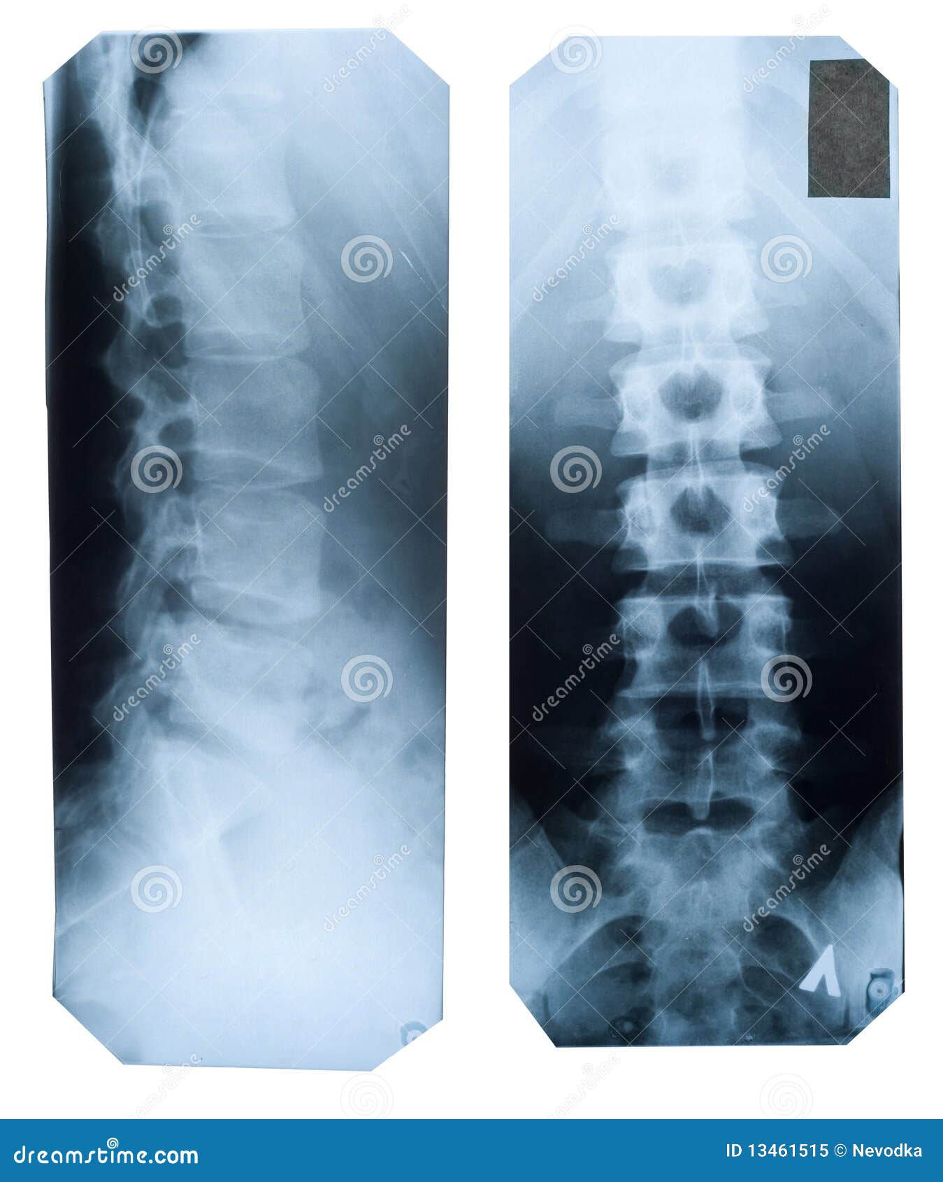 X-ray of young male spine stock image. Image of radiological - 13461515