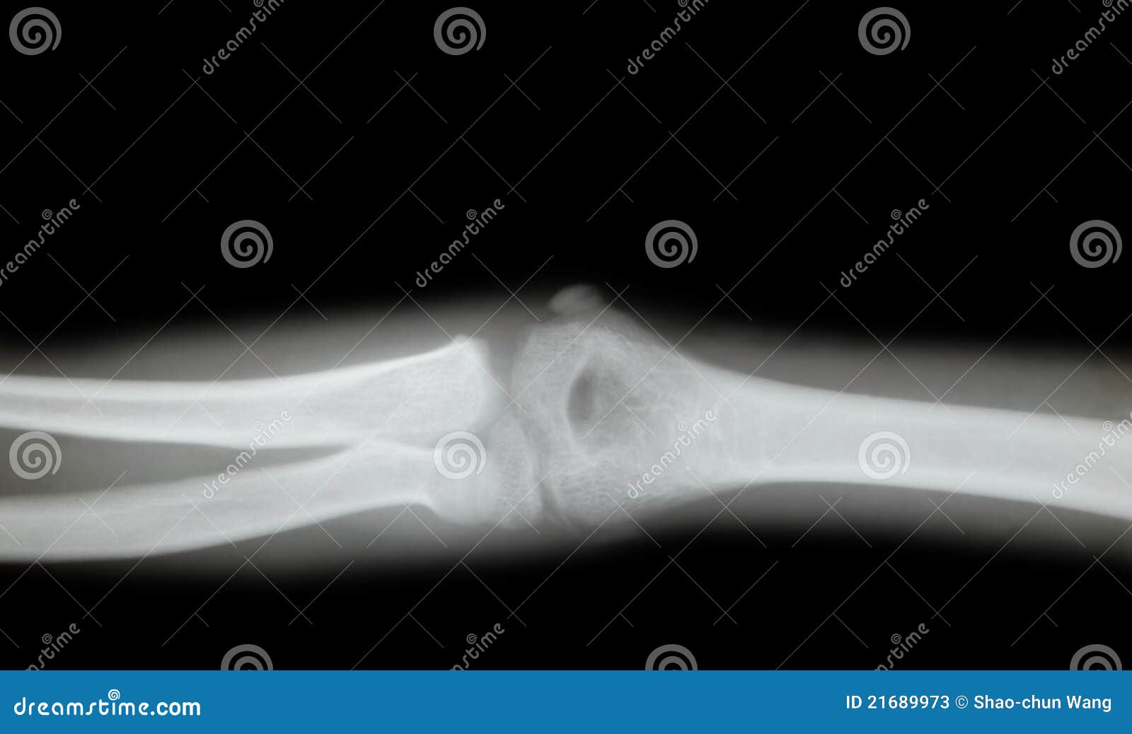 X-ray of a young mans arm stock image. Image of elbow - 21689973