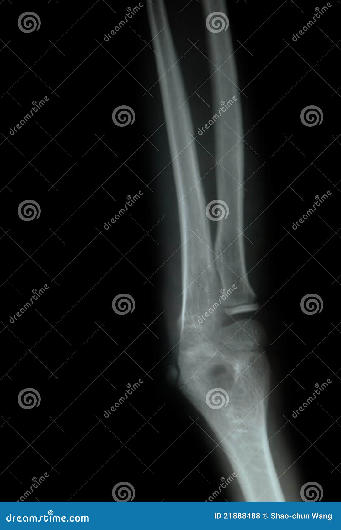 X-ray of a Young People Arm Stock Photo - Image of radiate, radiation ...