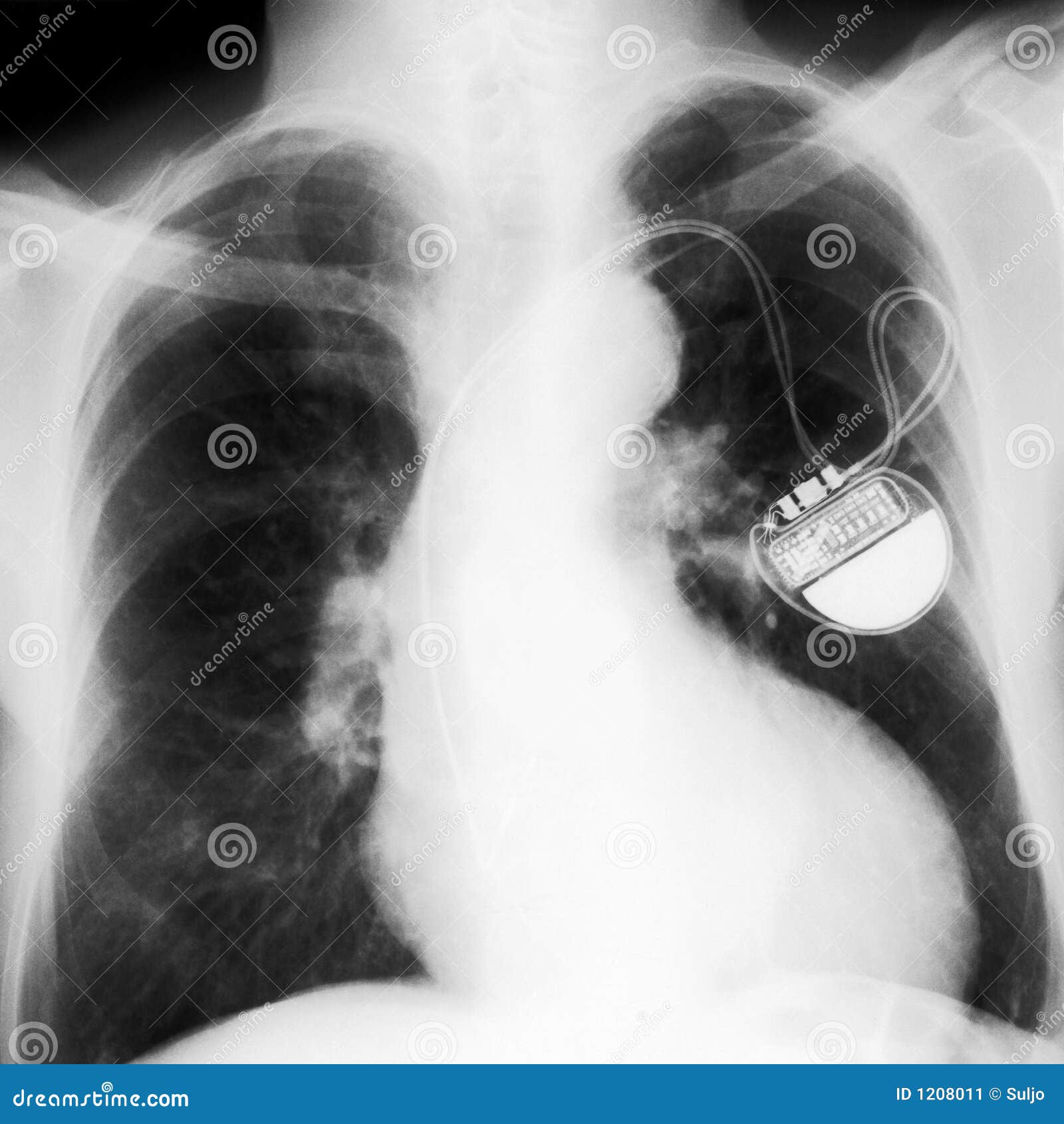 X-rayed chest stock image. Image of lungs, glow, roentgen - 1208011