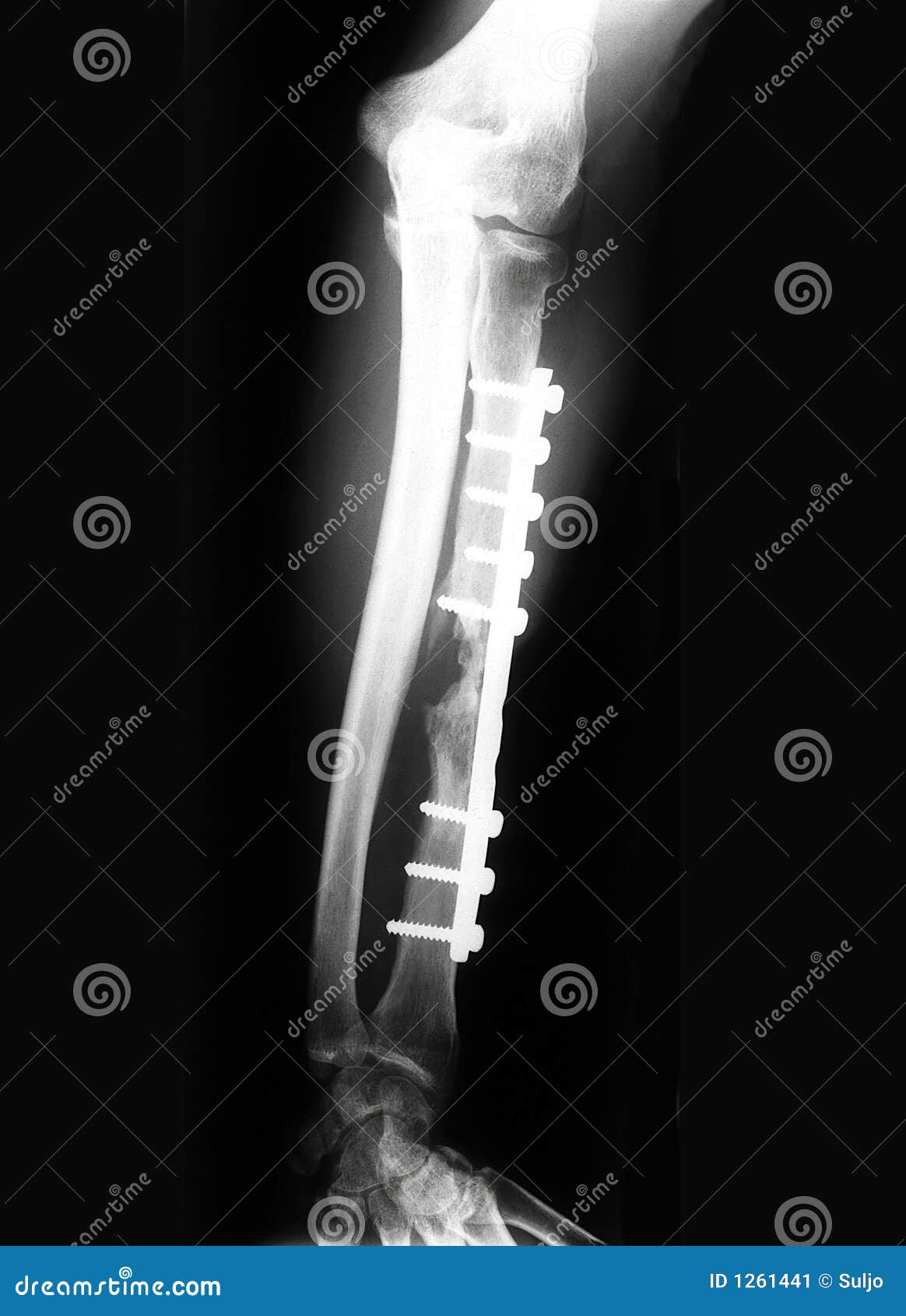 X-Rayed Forearm stock image. Image of negative, bones - 1261441