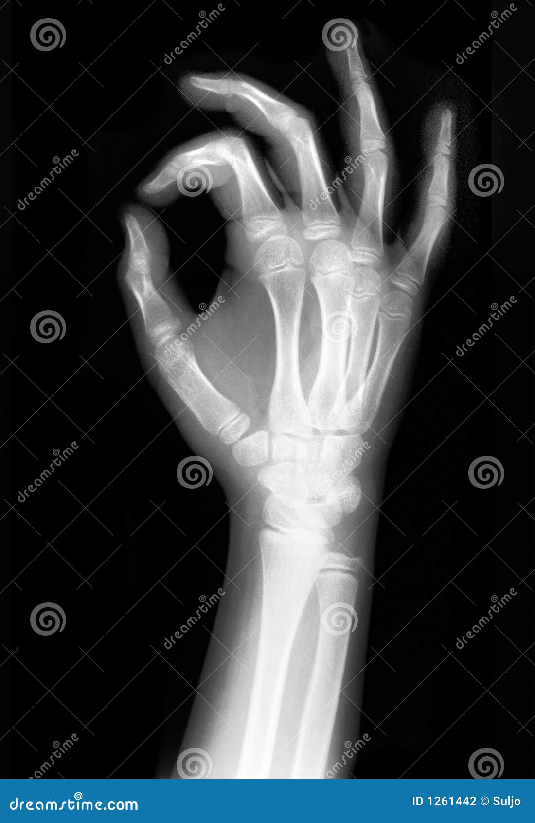 X-rayed Hand stock photo. Image of skeletal, care, screen - 1261442