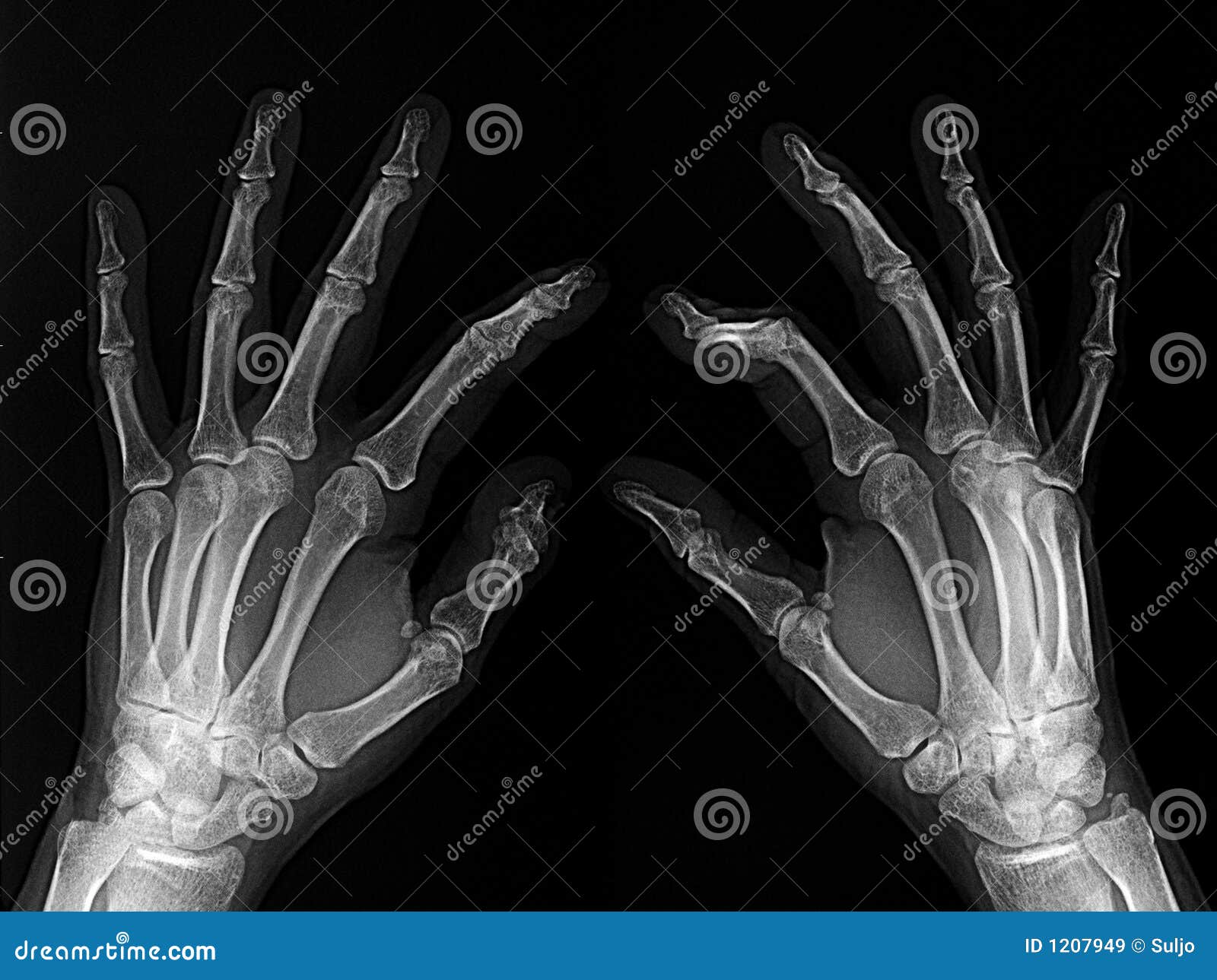 X-rayed hands stock image. Image of healthcare, injure - 1207949