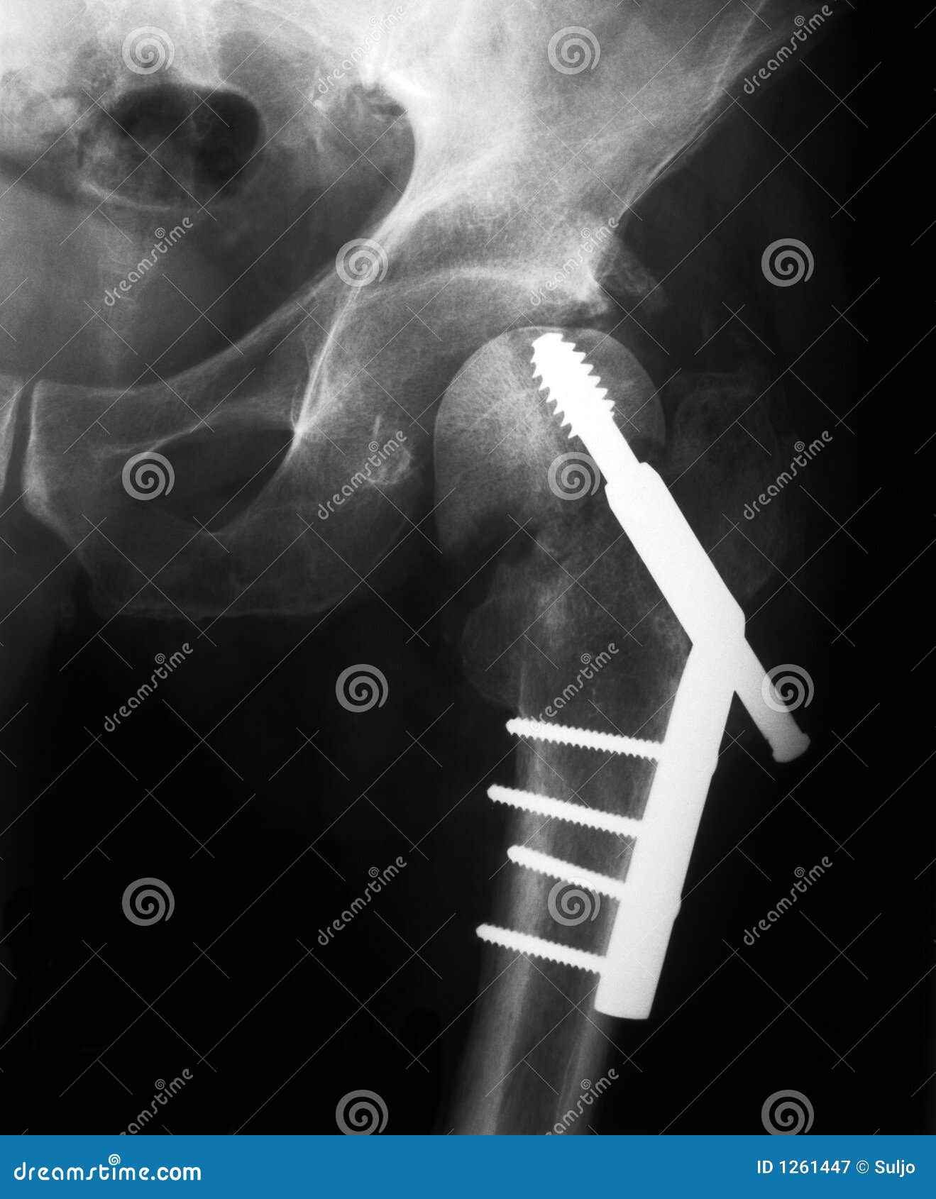 X-Rayed hip stock image. Image of radiation, arthritis - 1261447