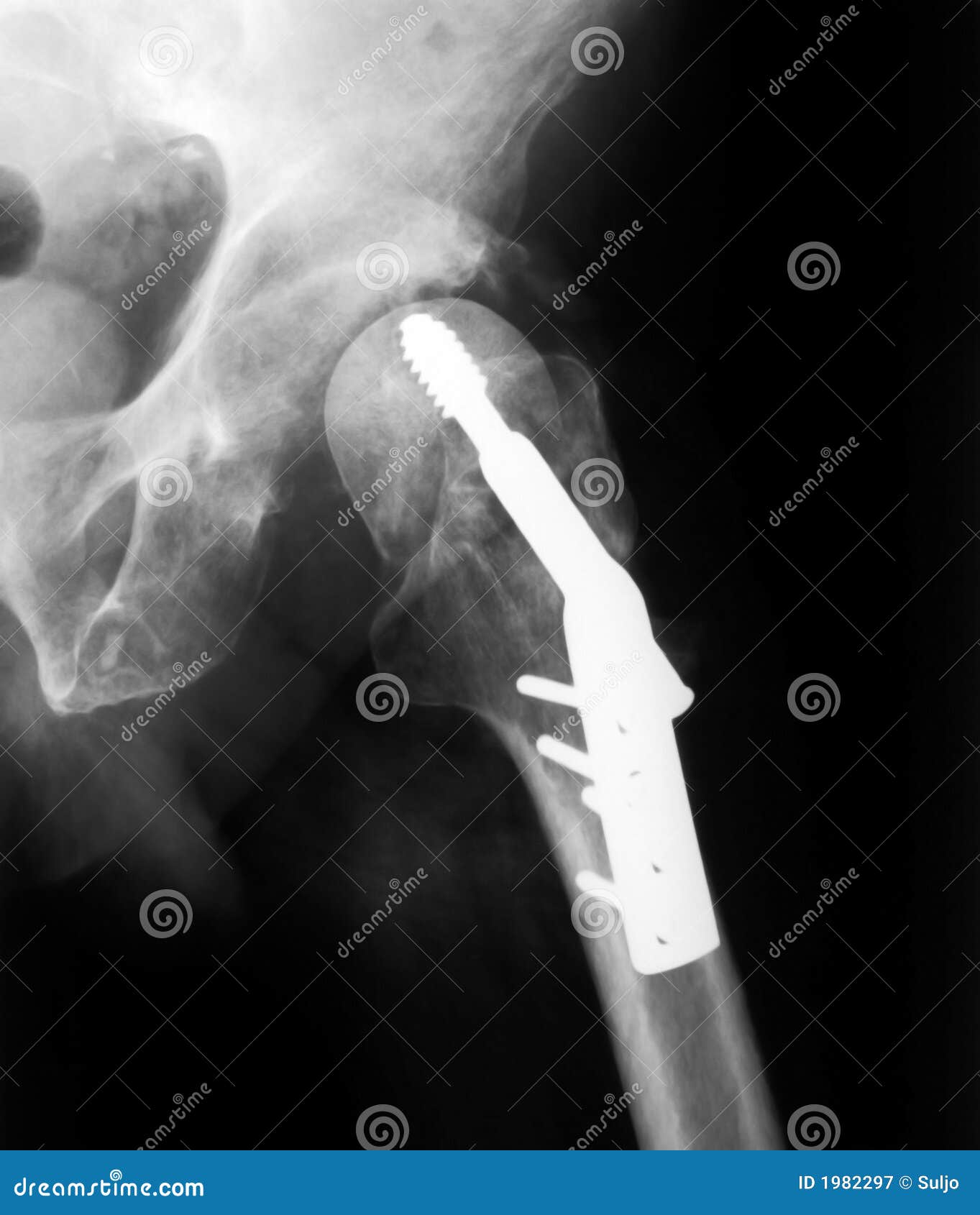 X-rayed Hip stock image. Image of hospital, bone, radiology - 1982297