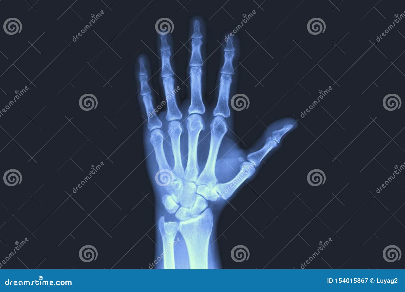X-rayed Human Hand. X-ray of Hand Bones. Stock Image - Image of ...