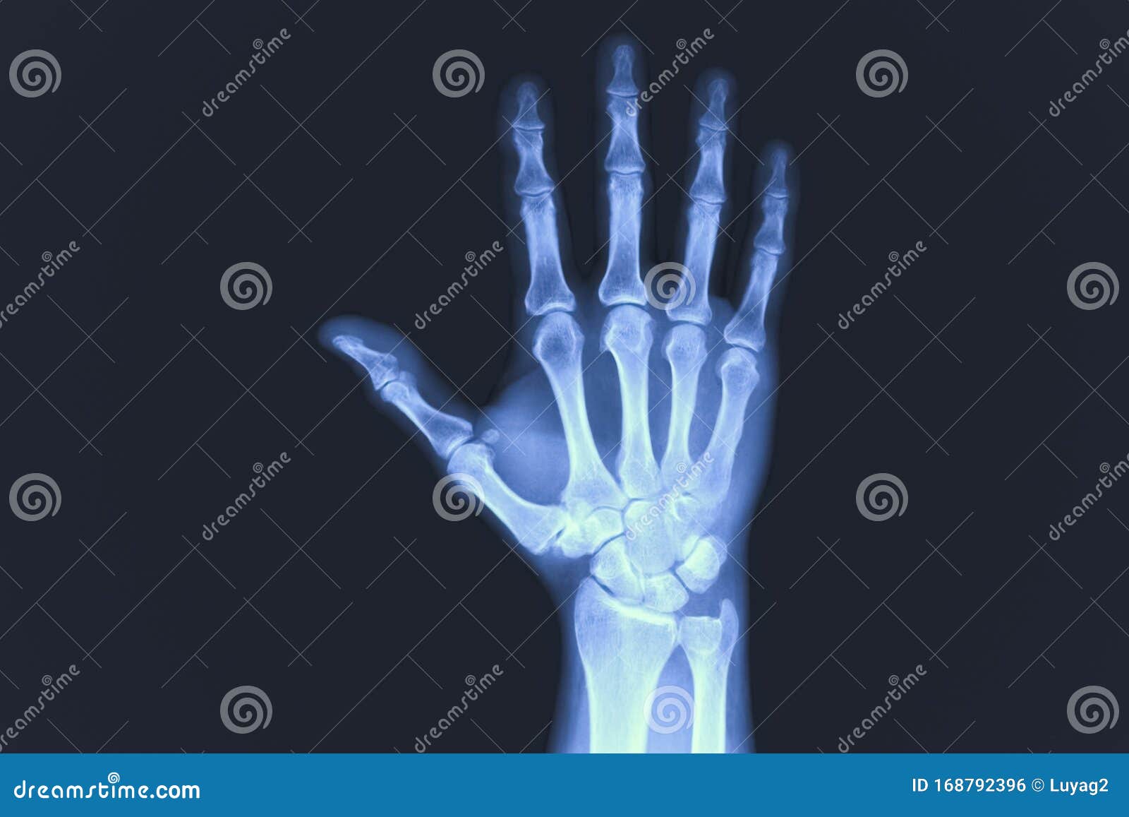 X-rayed human hand stock photo. Image of radiography - 168792396
