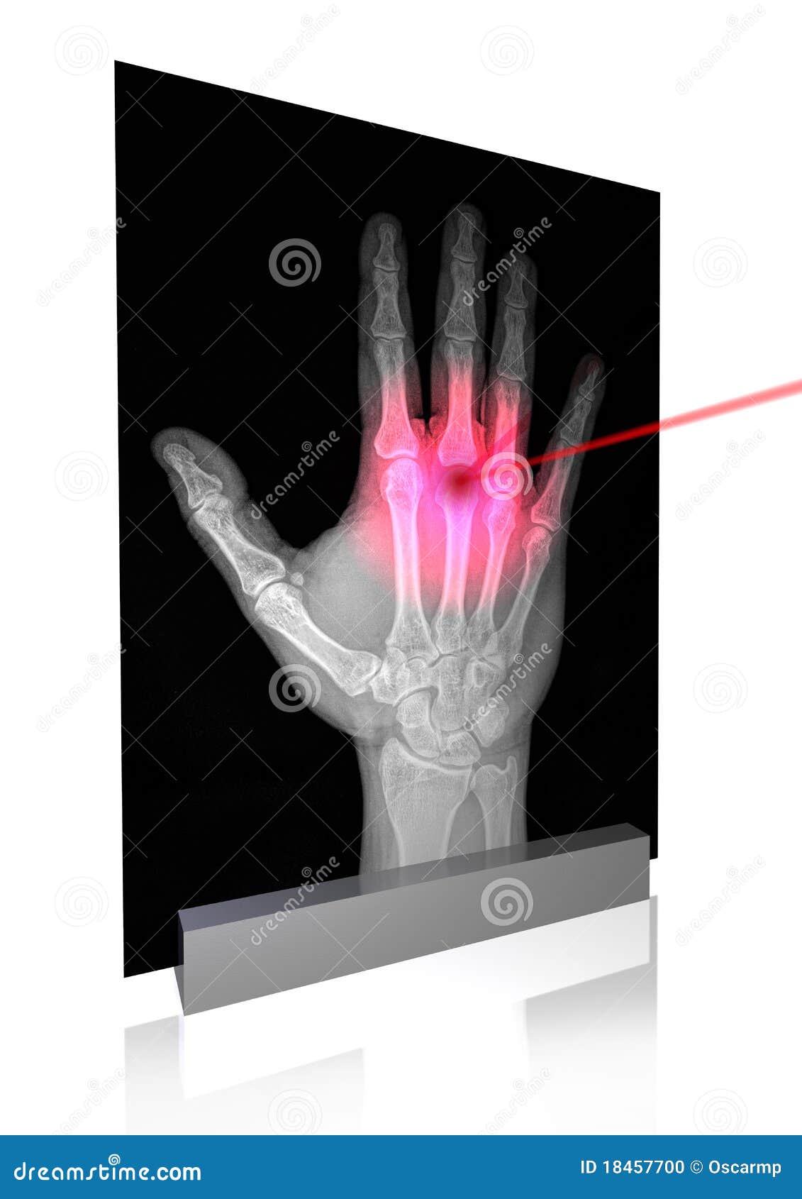 X-rays-1 stock illustration. Illustration of pain, arthritis - 18457700