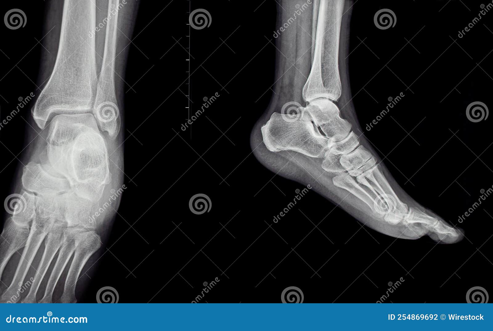 X-rays of the Human Foot from Two Angles Stock Photo - Image of human ...