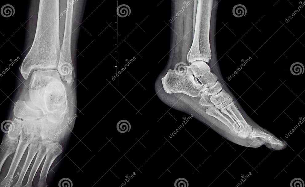 X-rays of the Human Foot from Two Angles Stock Photo - Image of human ...