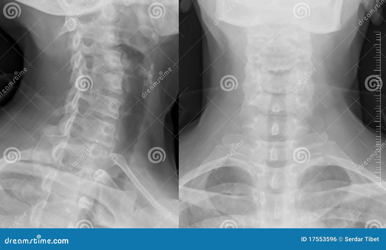 X-rays of human neck stock photo. Image of curved, ligaments - 17553596