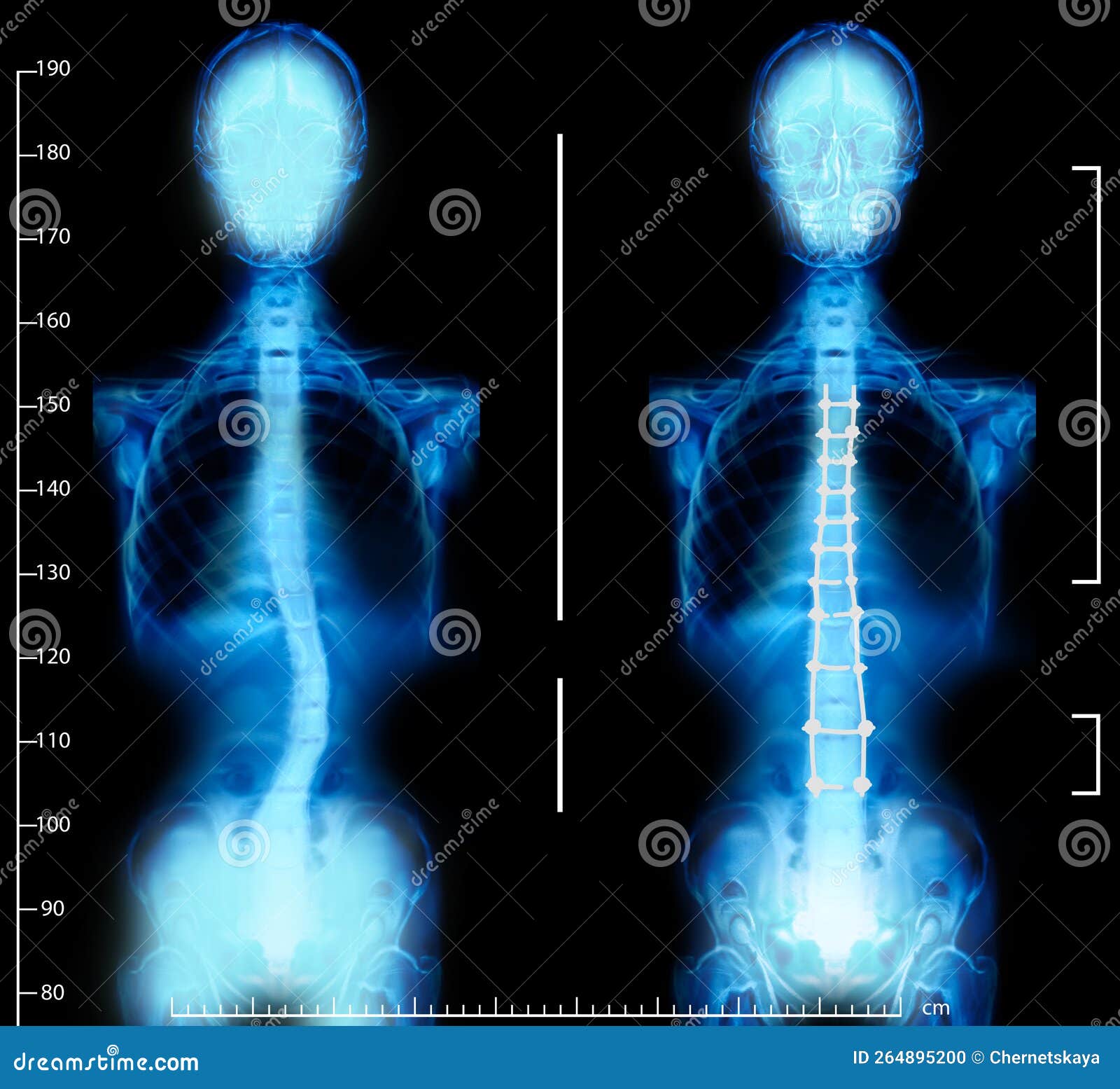 X-rays of Human Normal and Curved Spines. Patient Suffering from ...