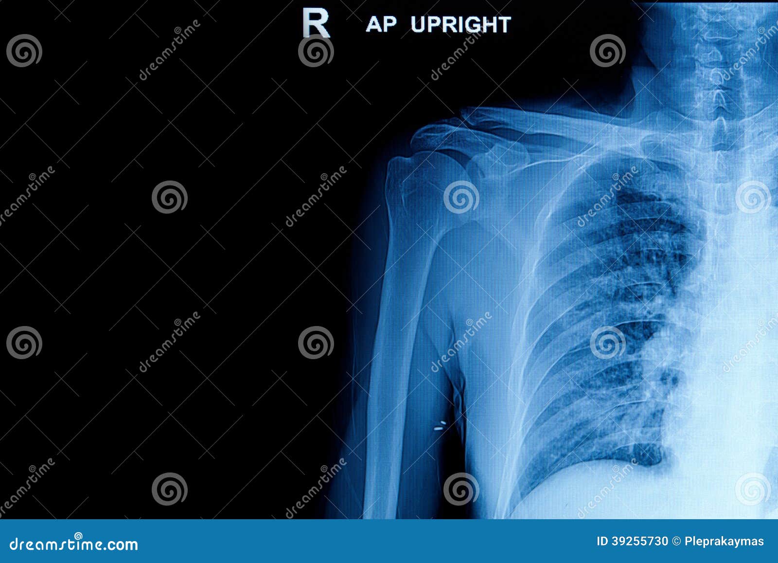 X-ray Image Of Shoulder Pain With Clavicle Fracture With Post-op And ...