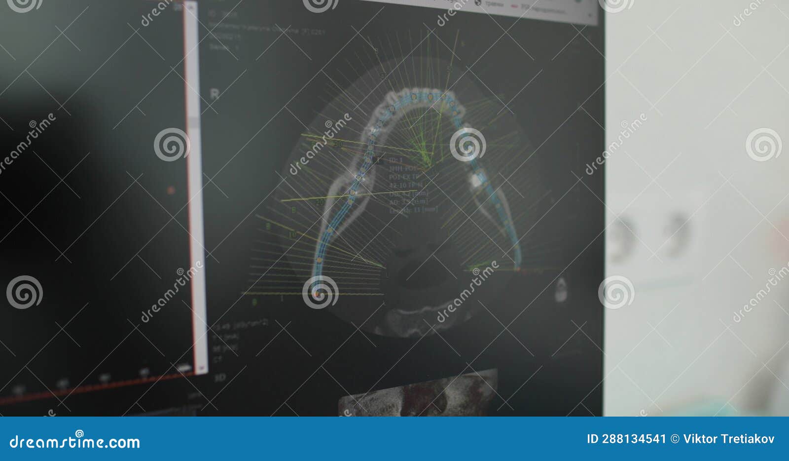 X-rays of the Jaws on the Screen in the Dental Office. Stock Image ...