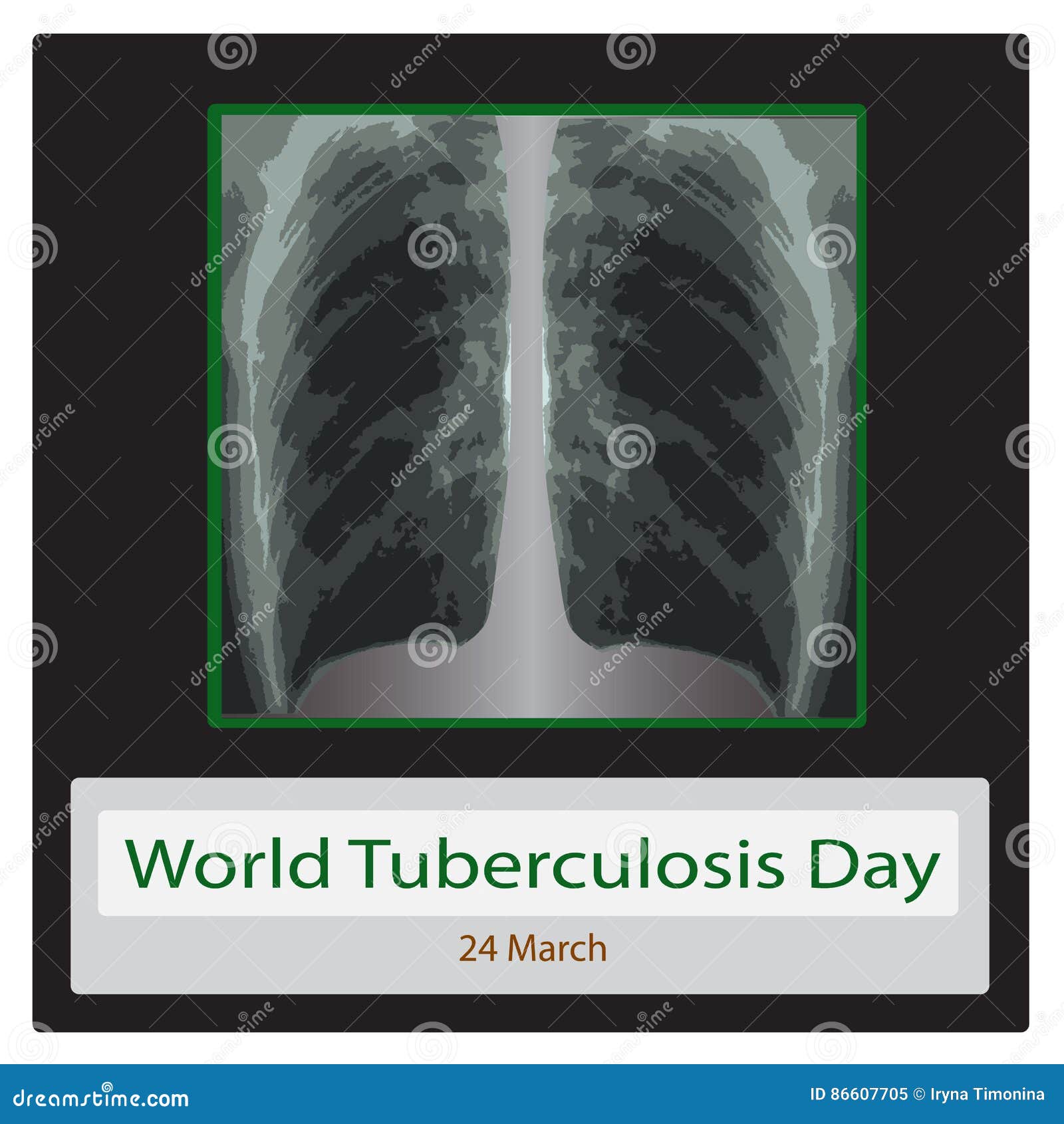 Tuberculosis (TB) Infographics Vector Illustration | CartoonDealer.com ...