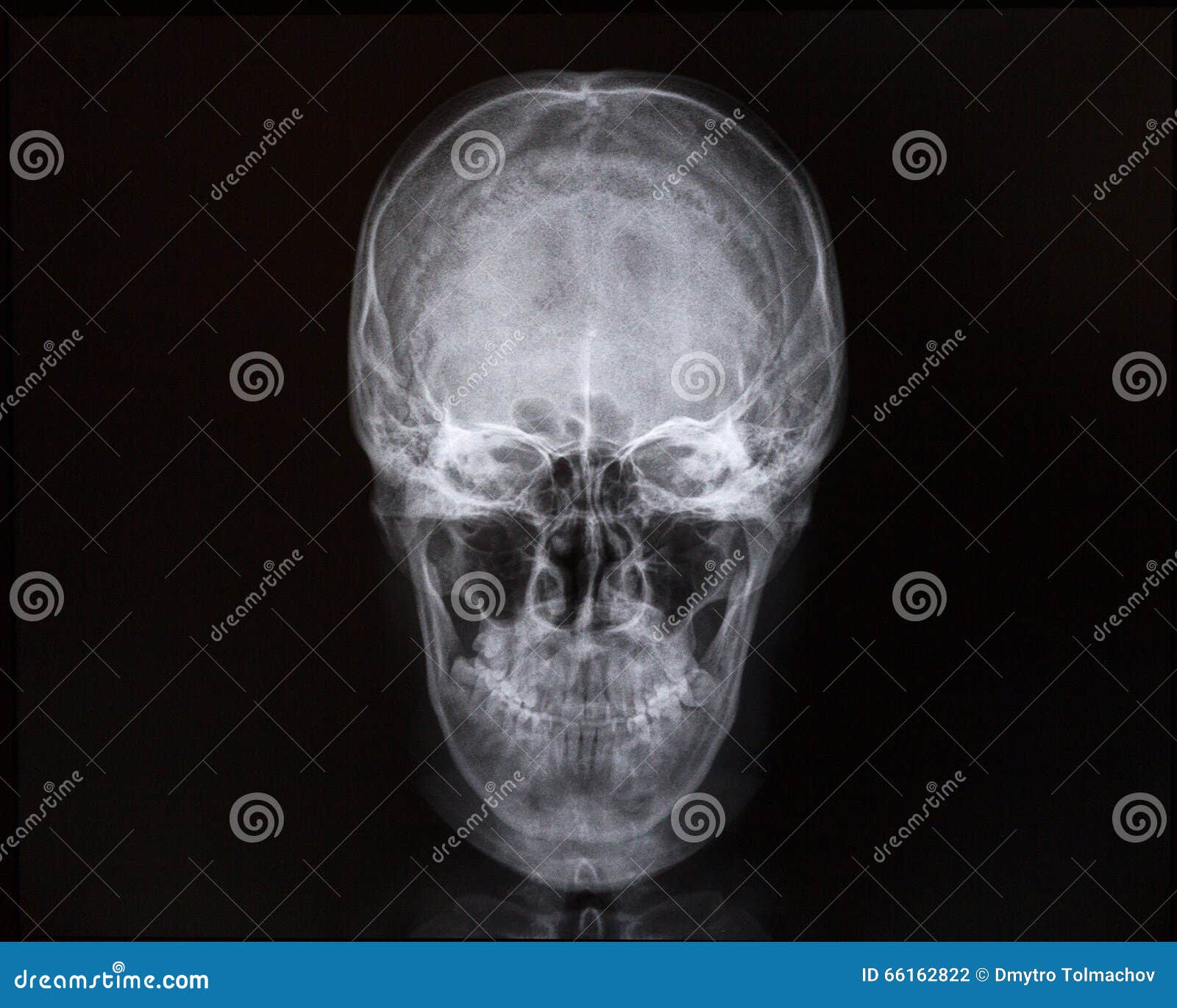 X-rays of Skull and Internal Cavity Stock Photo - Image of body ...