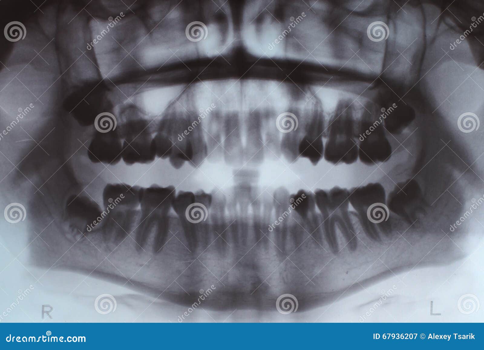 X-rays of teeth stock image. Image of dentistry, medical - 67936207