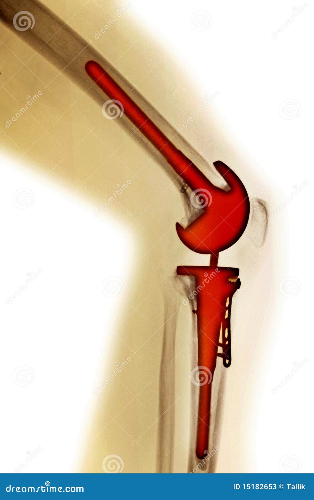 Xray, 46 Year Old Female, Total Knee Replacement Stock Image - Image of ...