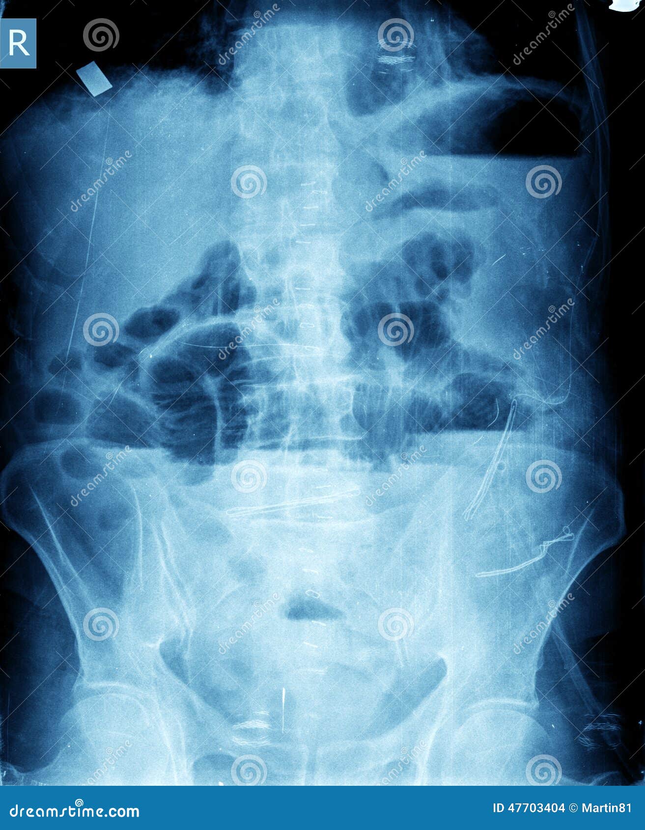 Xray abdomen stock photo. Image of intestine, care, exam - 47703404