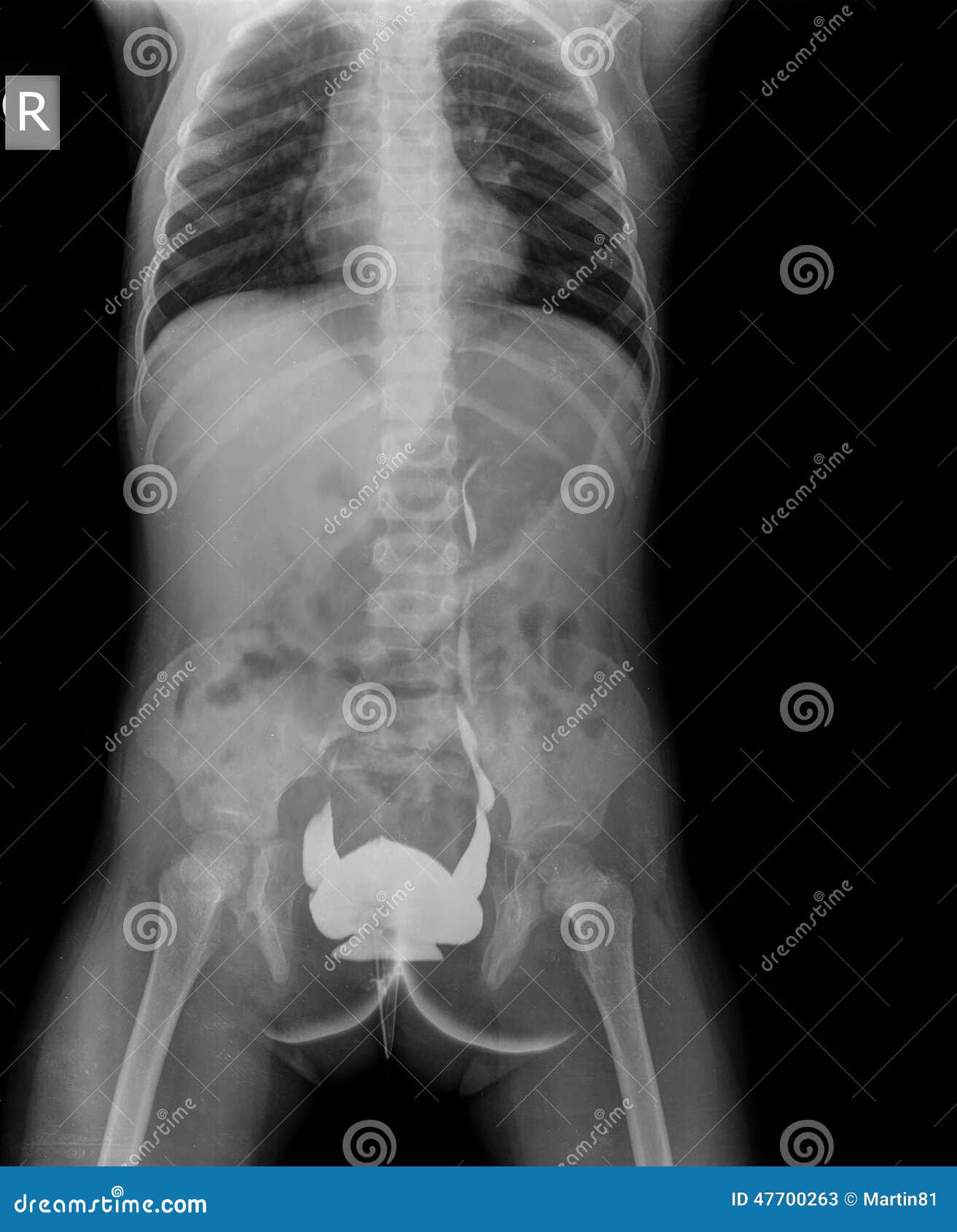 Xray Abdomen Stock Photo - Image: 47700263