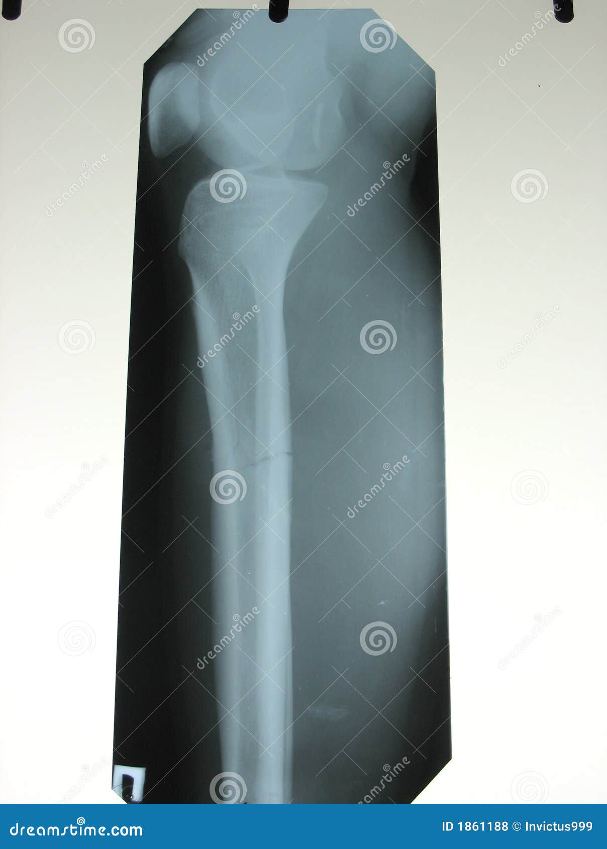 Xray of a broken leg bone stock photo. Image of skeleton - 1861188