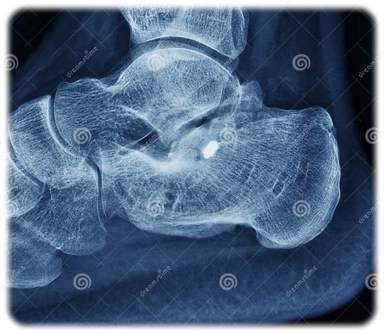 Xray calcaneus stock illustration. Illustration of imagiologia - 43185613
