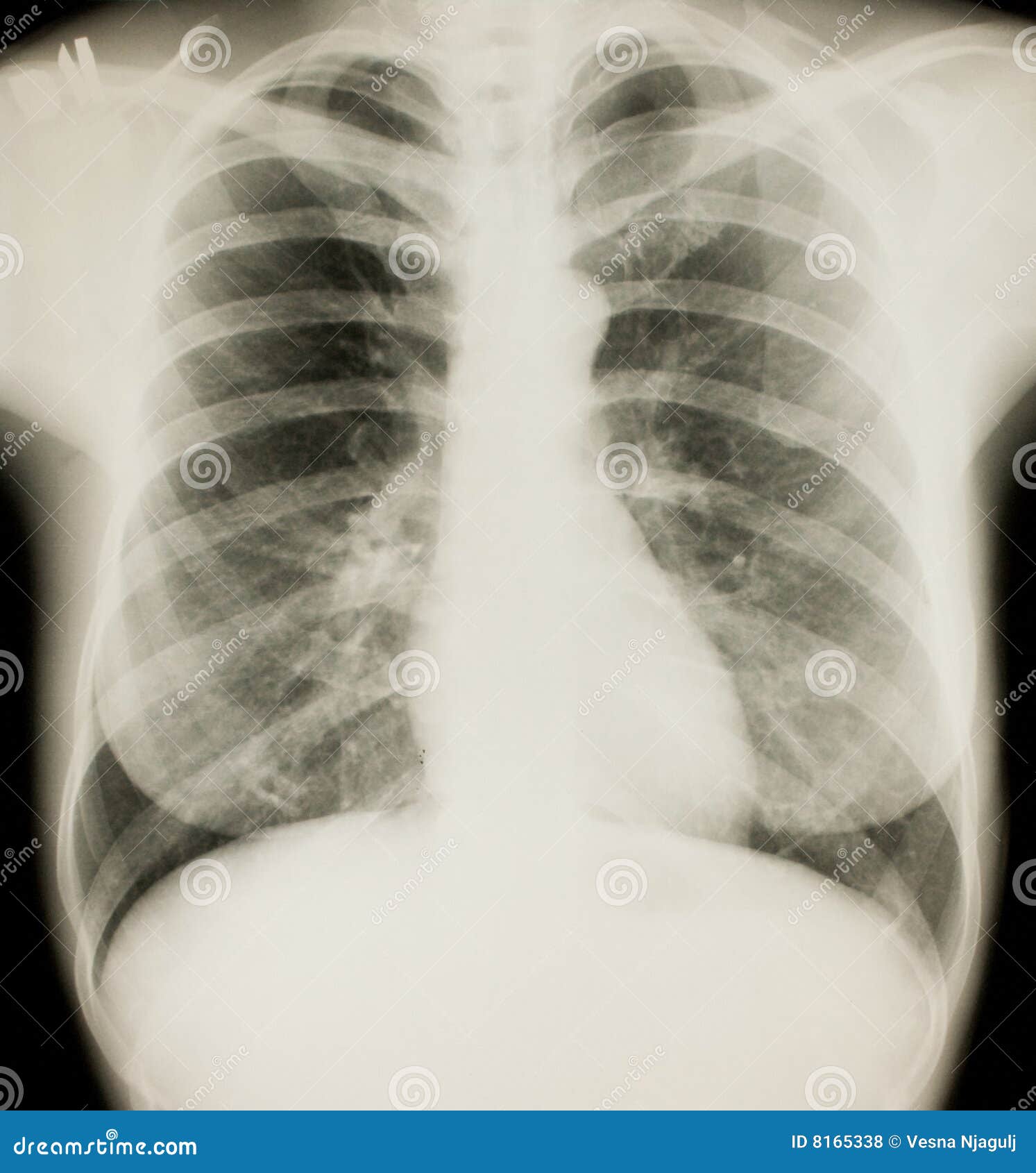 Xray of chest, normal stock photo. Image of cancer, radiation - 8165338