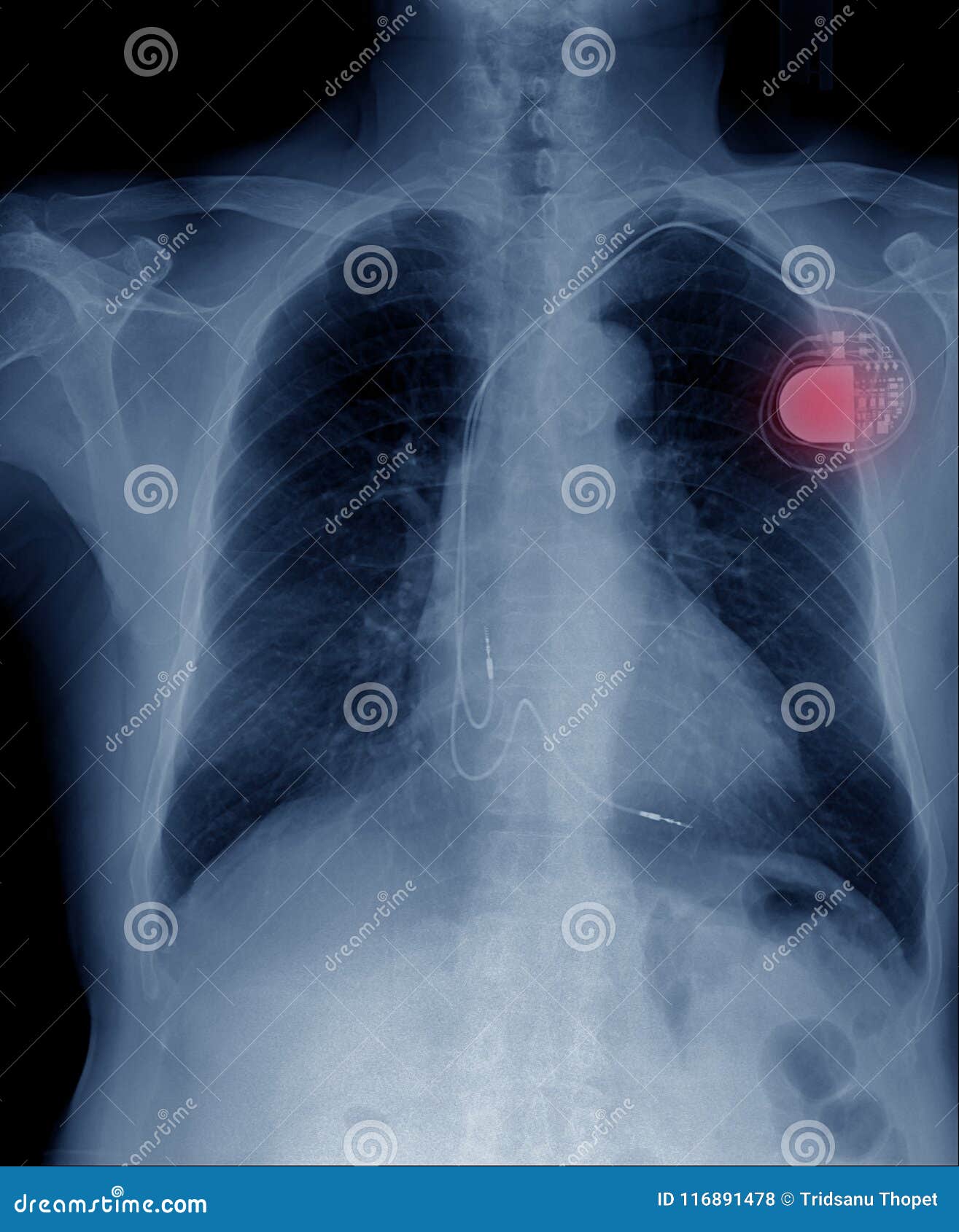 Pacemaker cell stock photo. Image of clinic, injury - 116891478