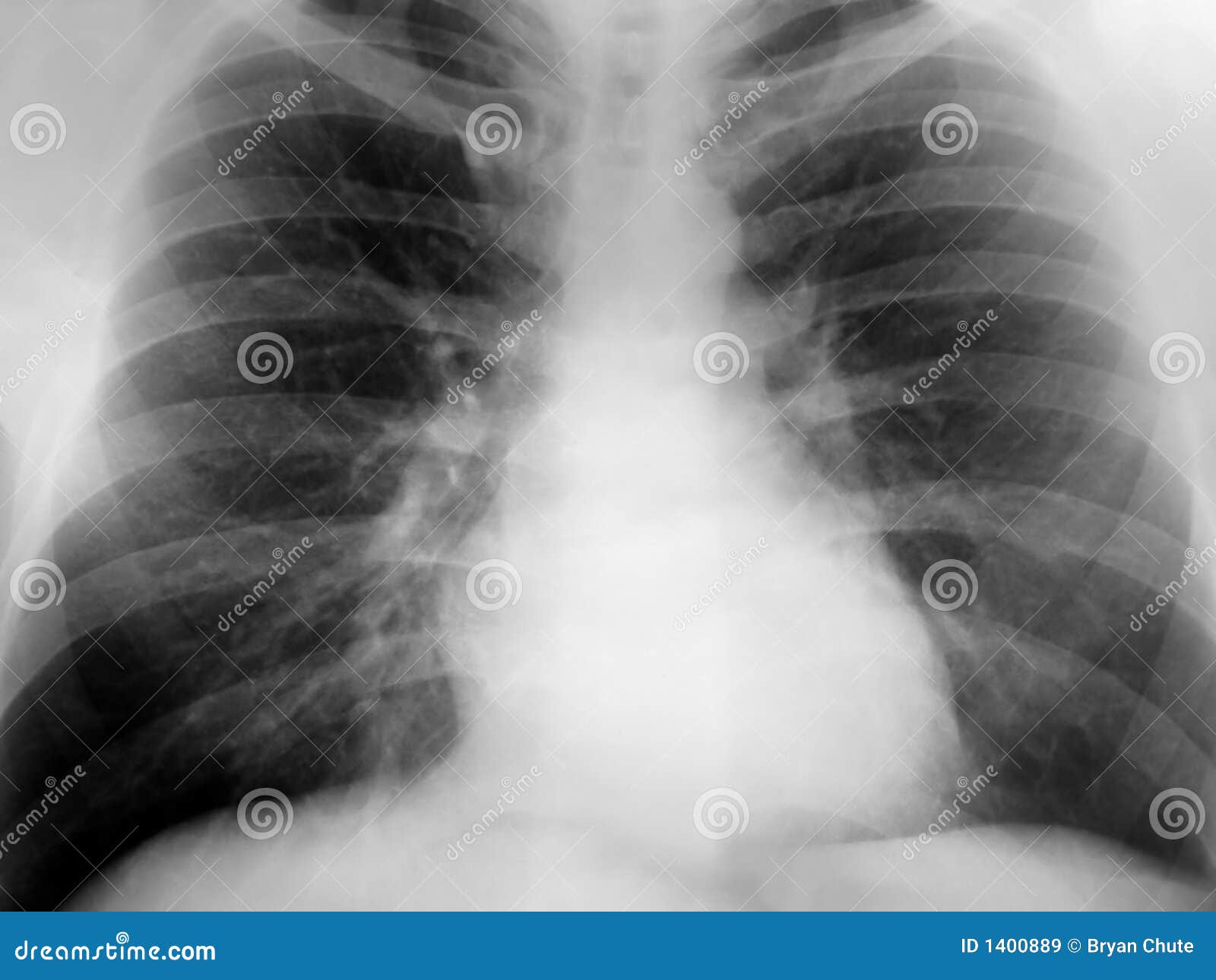 Xray Chest Positive stock image. Image of inside, anatomy - 1400889