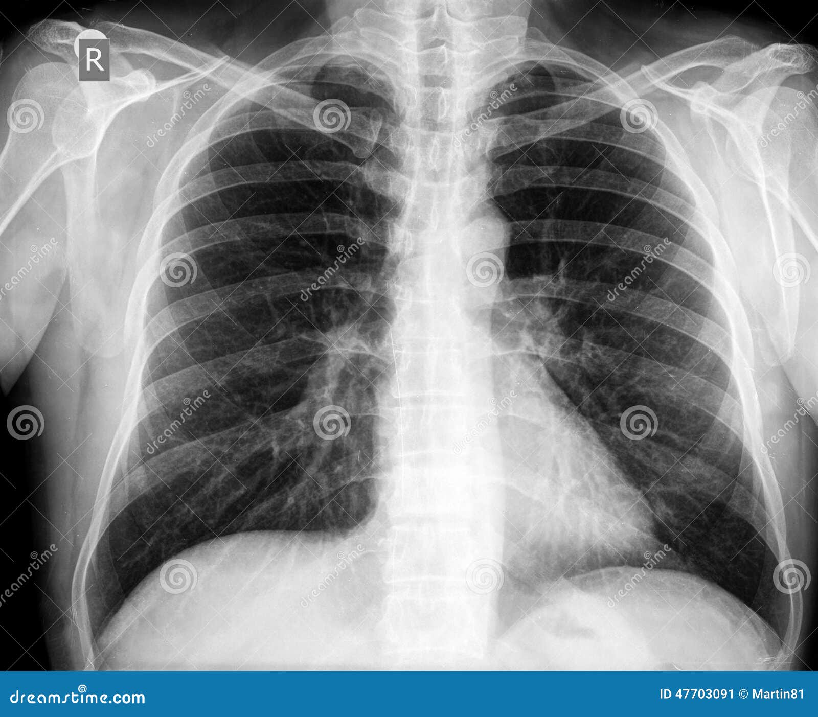 Xray chest stock image. Image of exam, healthcare, hospital - 47703091