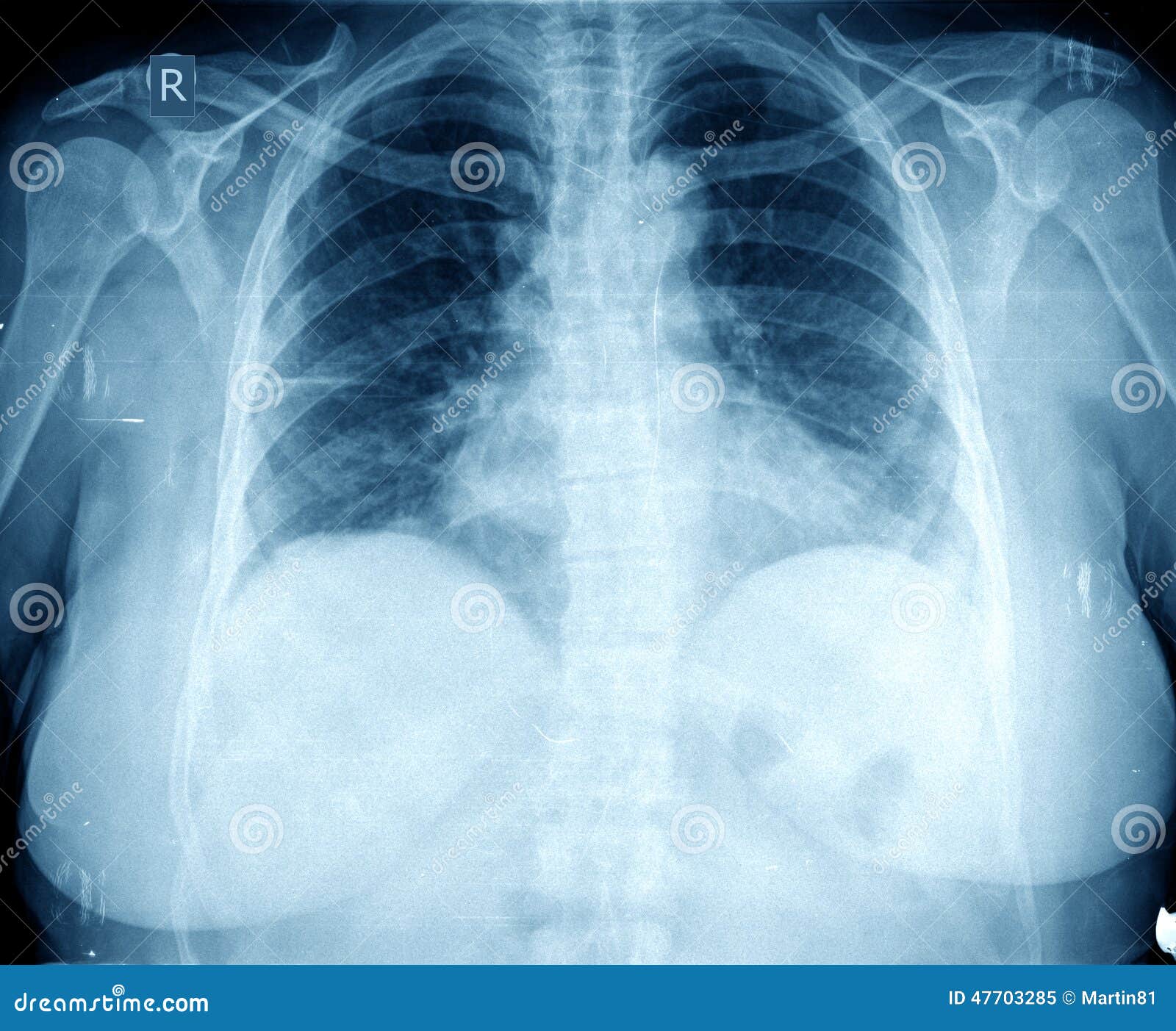 Xray chest stock image. Image of doctor, bone, abdomen - 47703285
