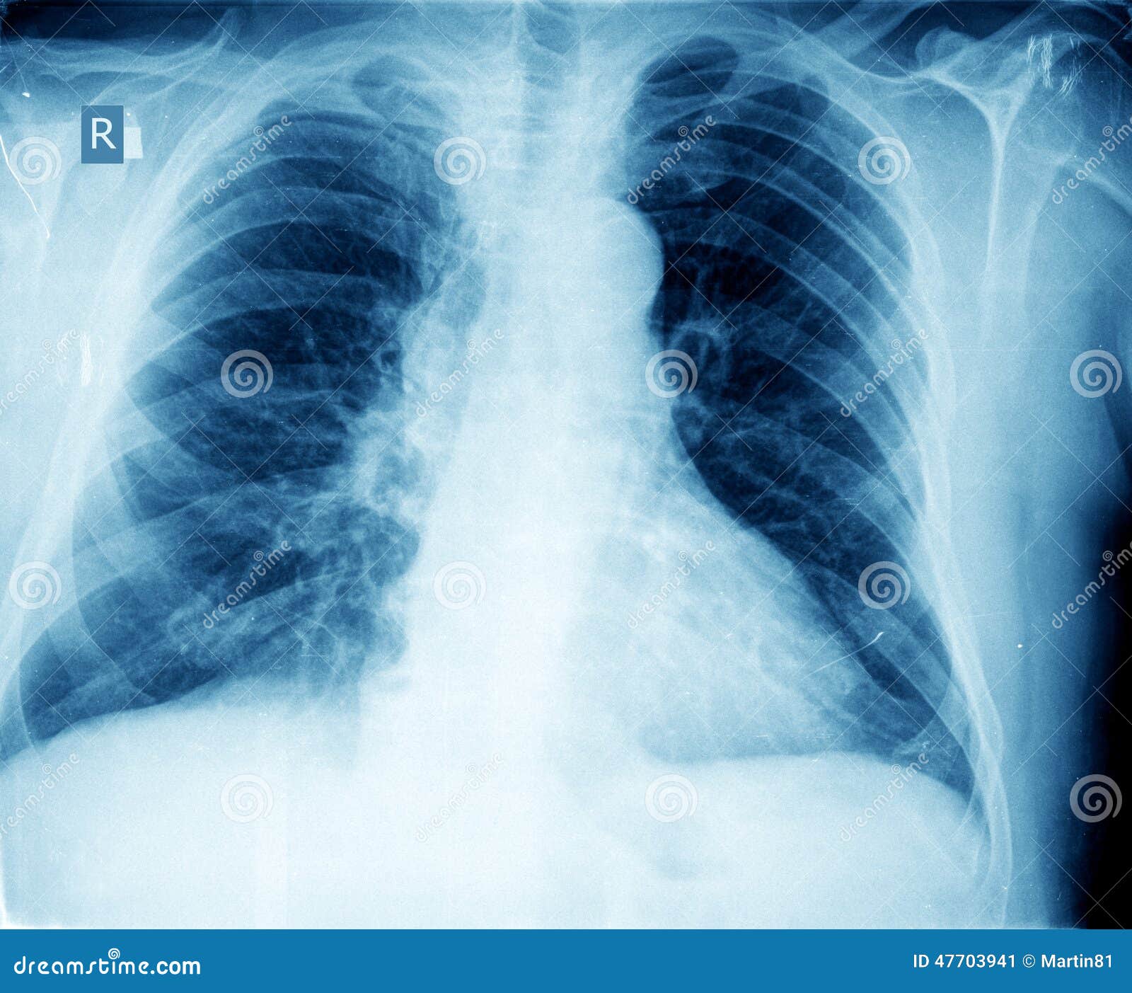 Xray Chest Stock Photo - Image: 47703941