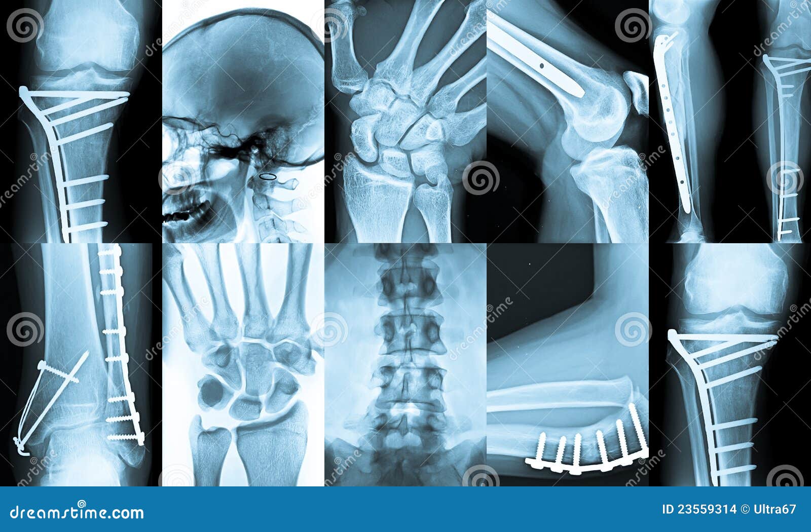 Xray Collage stock photo. Image of hospital, bones, body - 23559314