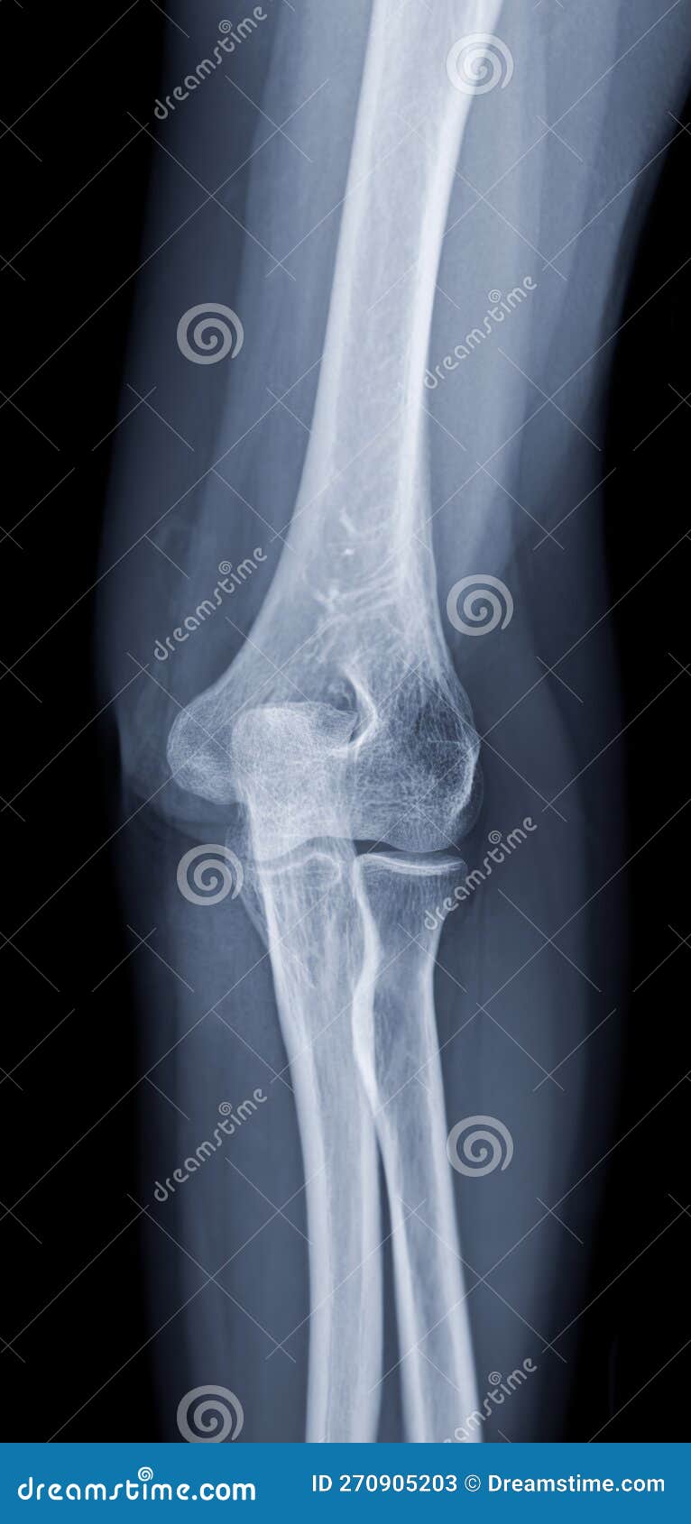 Xray De La Jointure Du Coude Montrant L'articulation Du Coude Normale ...