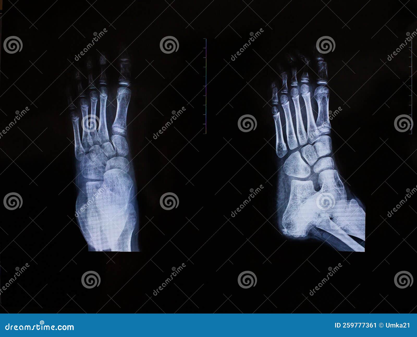 Xray Del Pie En Dos Proyecciones Imagen de archivo - Imagen de ...