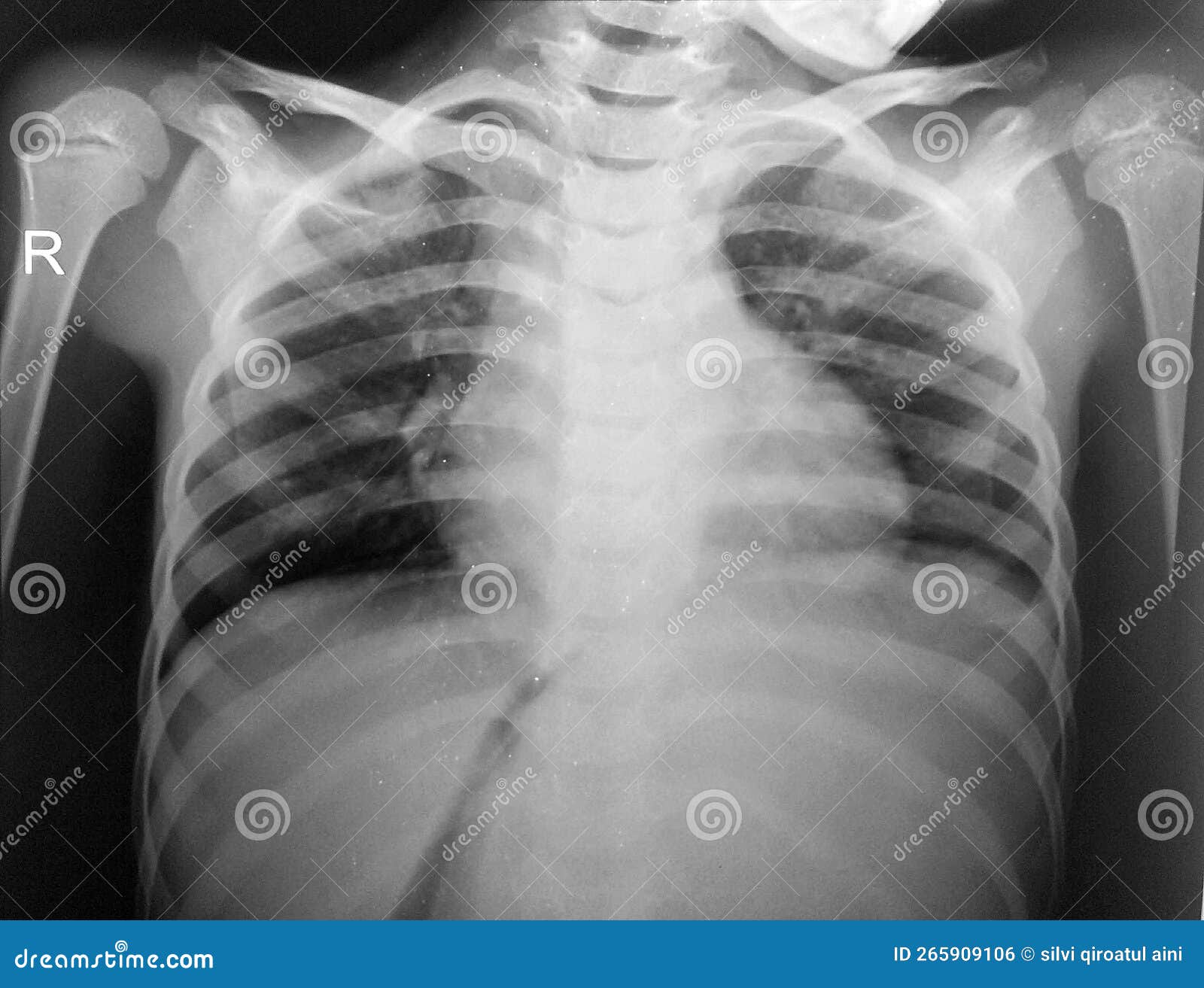Xray Examination Abdomen Pelvis Shrapnel War Victim Stock Image ...