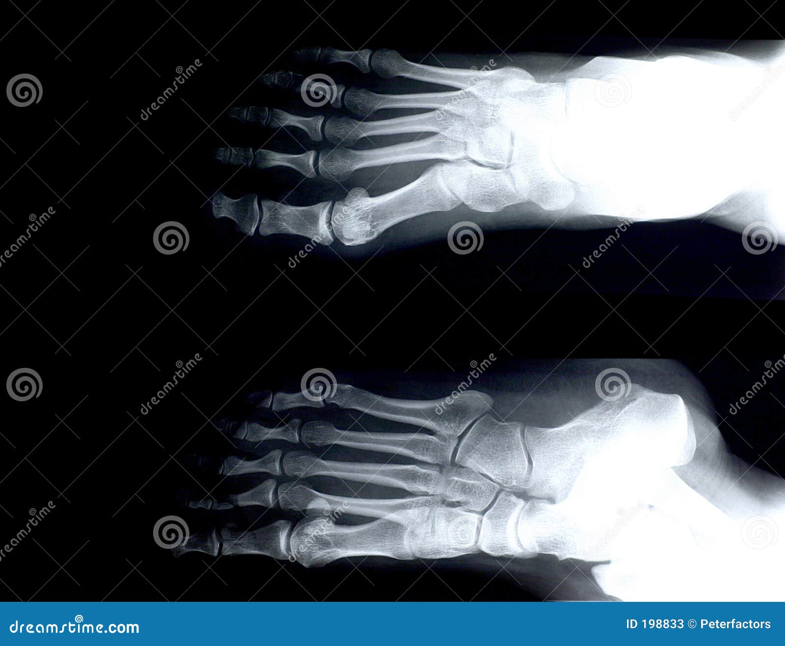 Xray/Foot front stock image. Image of feet, foot, clinic - 198833
