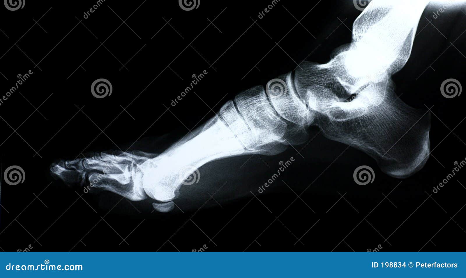 Xray/Foot side stock photo. Image of fracture, internal - 198834